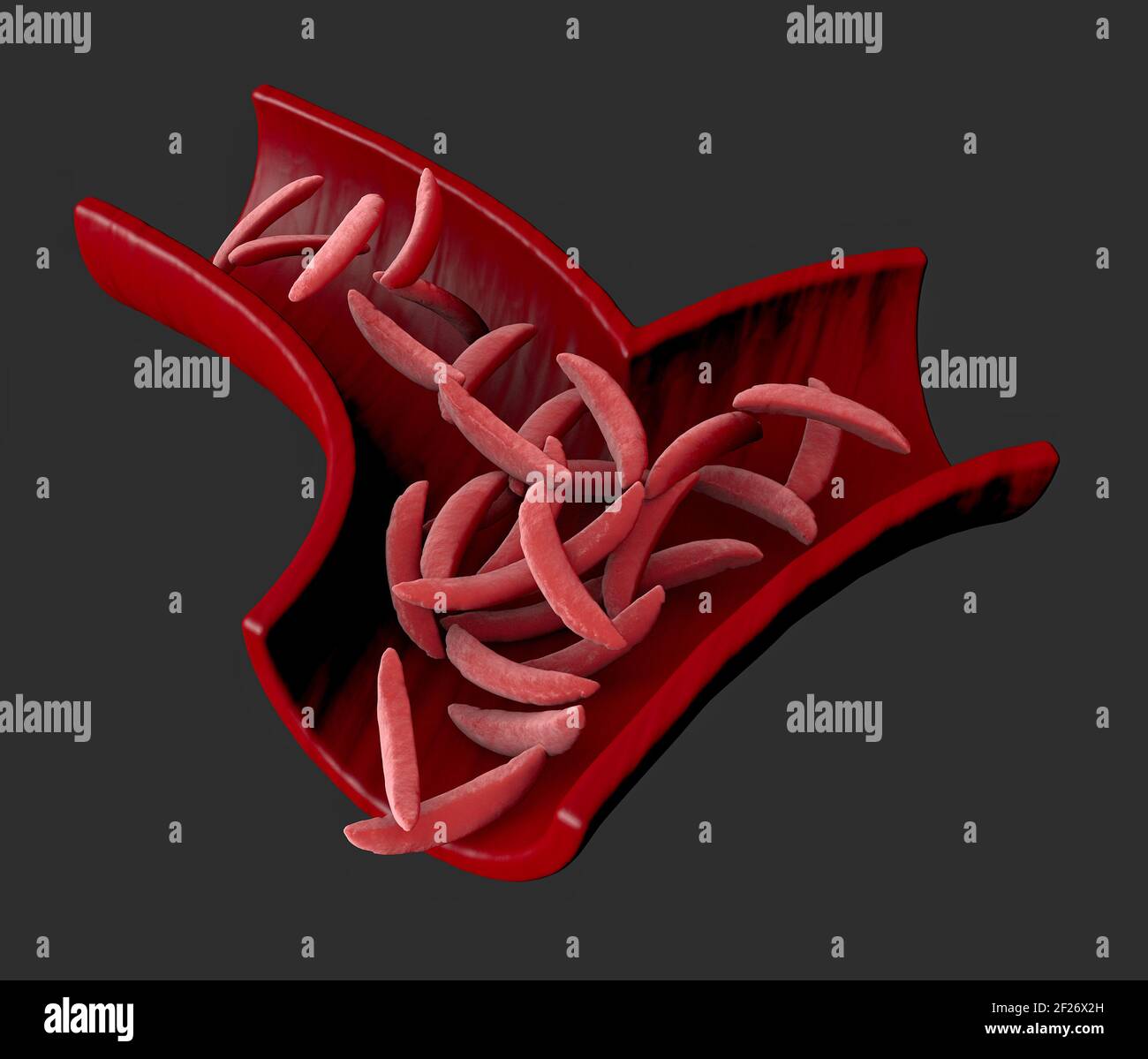 Williams syndrome Banque de photographies et d’images à haute ...