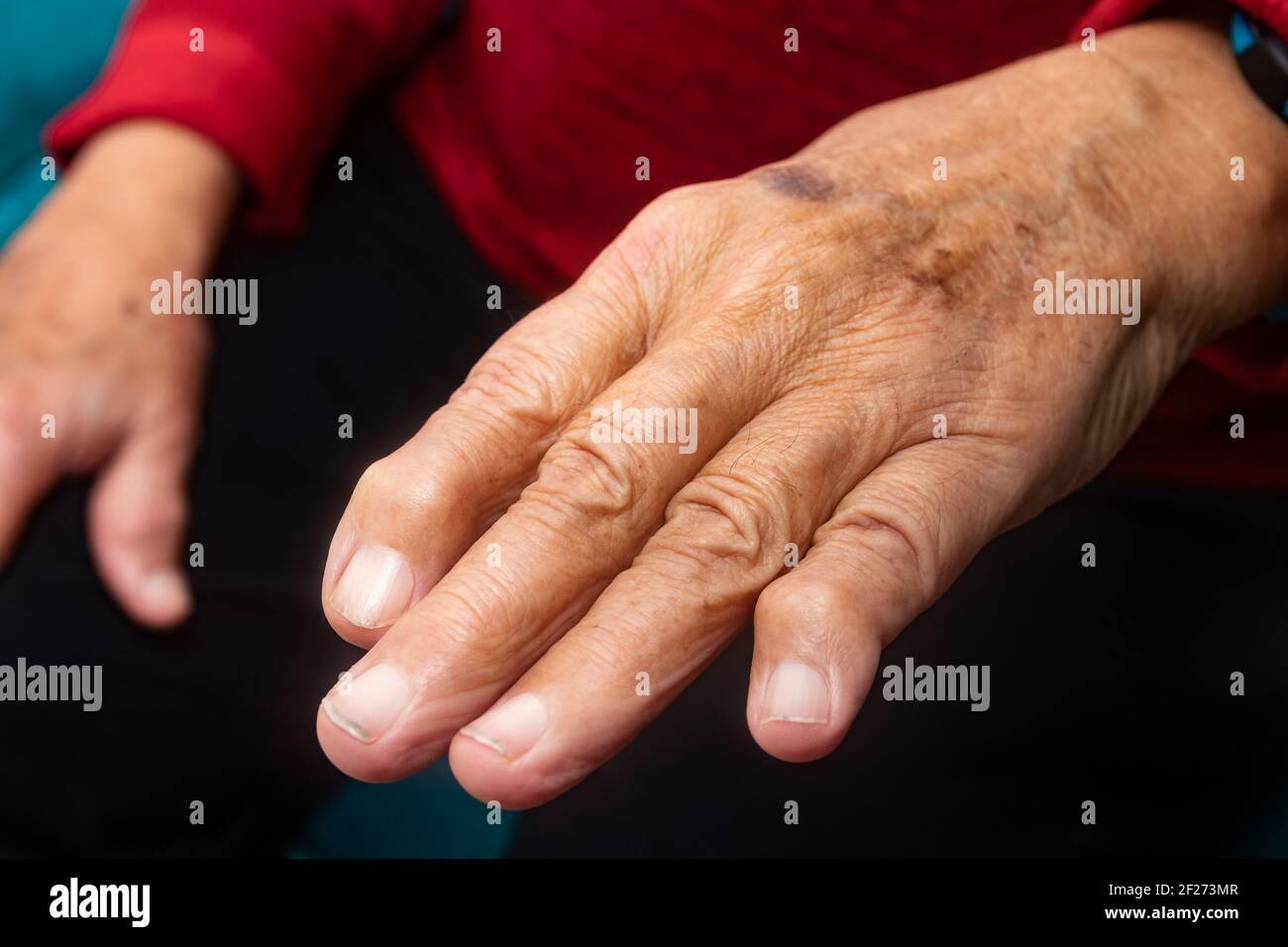 Arthrose du poignet Banque de photographies et d’images à haute ...