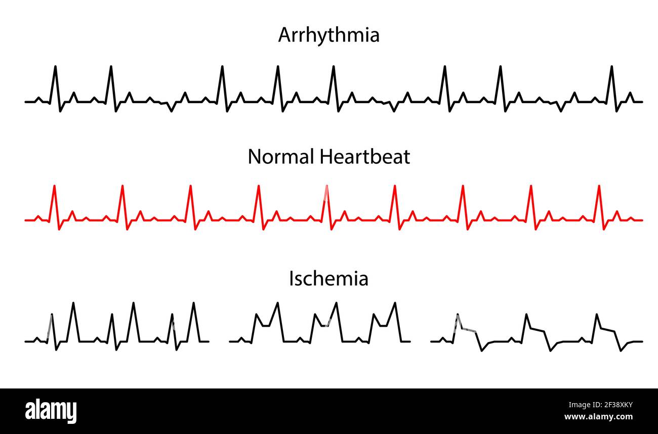 Définir les lignes battements cardiaques normaux, arythmie et ischémie ...