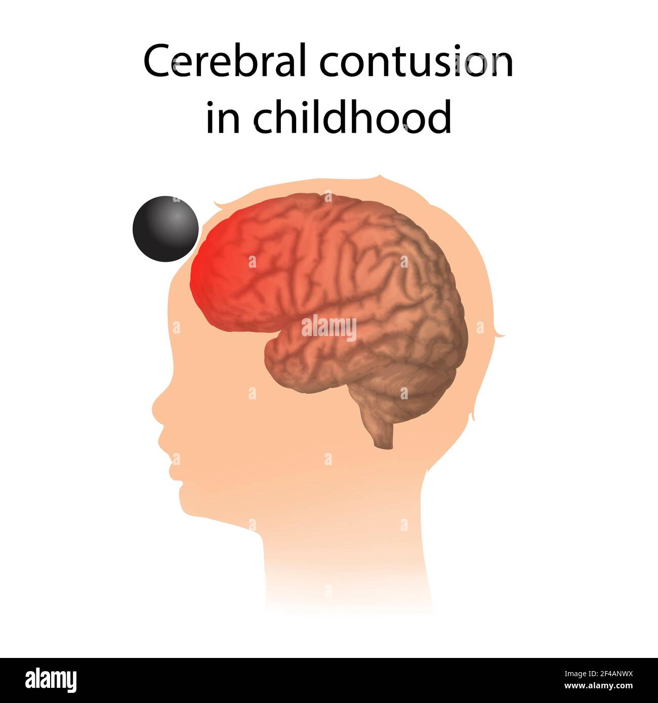 Contusion cérébrale Banque de photographies et d’images à haute ...
