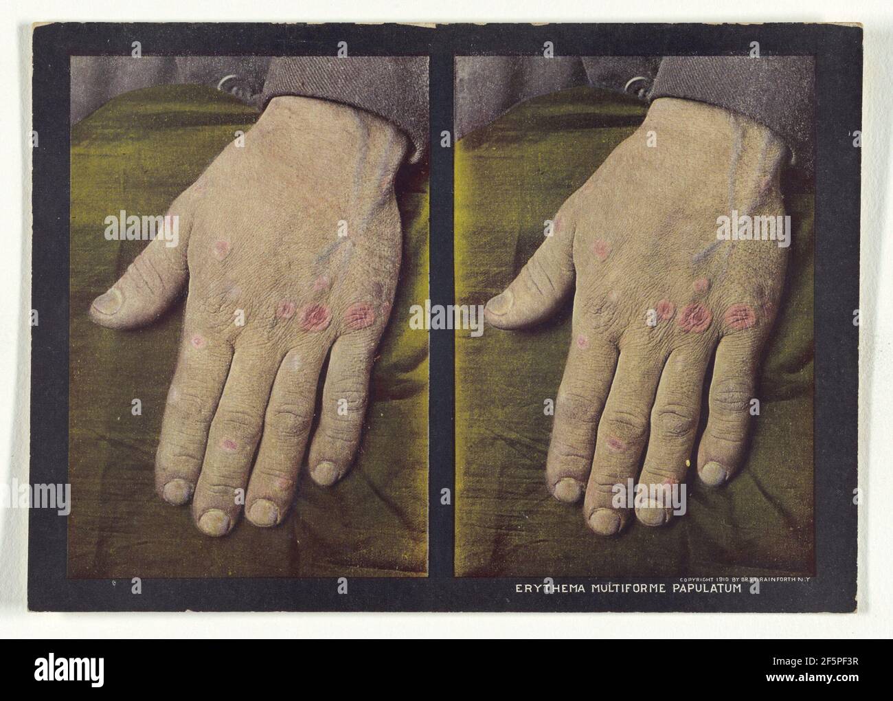 Erythema multiforme Banque de photographies et d’images à haute ...