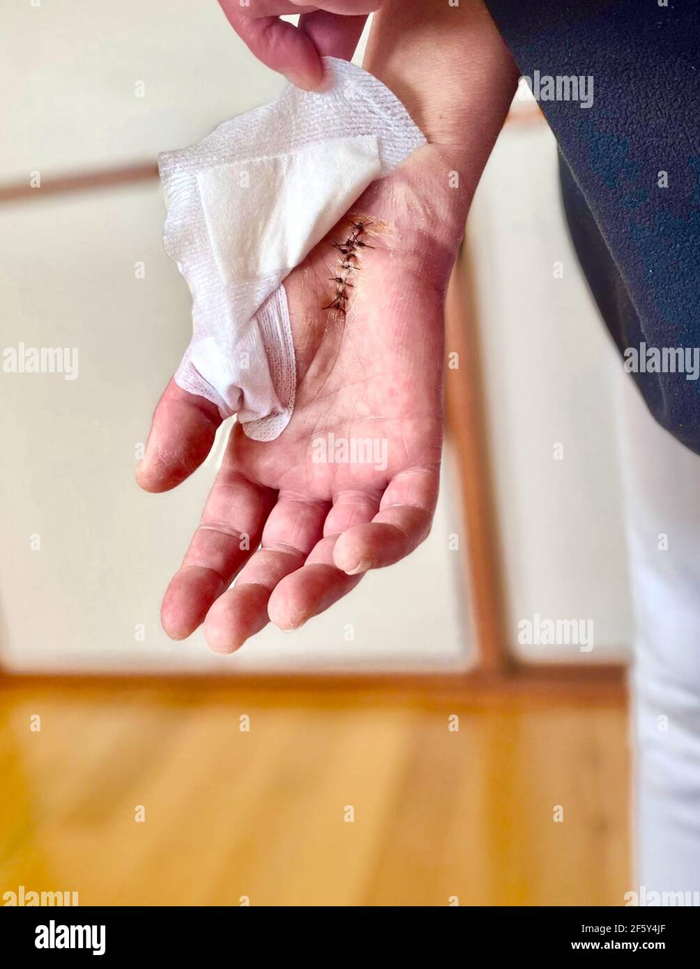 Points de suture dans la peau Banque de photographies et d’images à ...