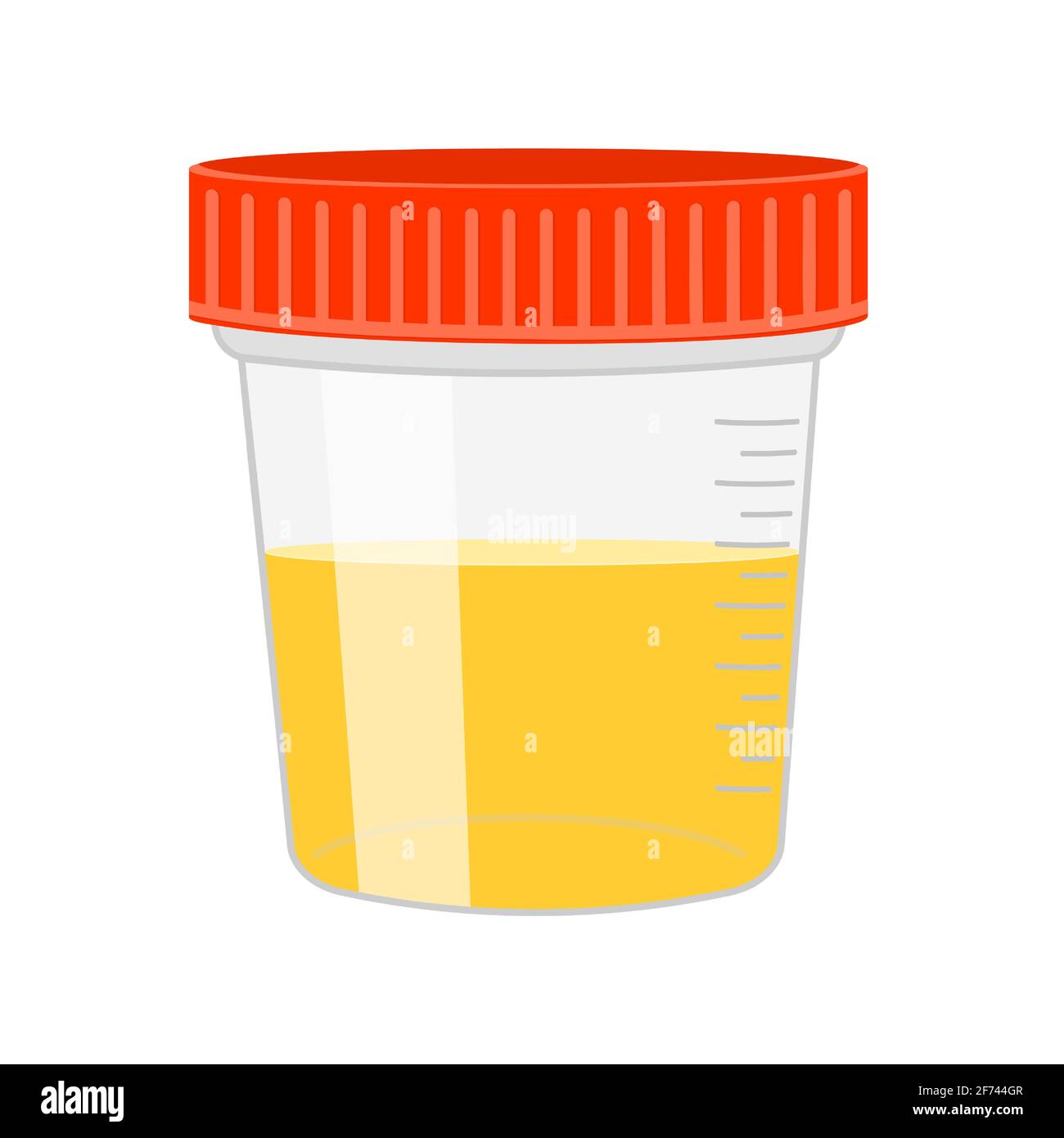Analyse d'urine. Échantillon d'urine dans un récipient en plastique ...