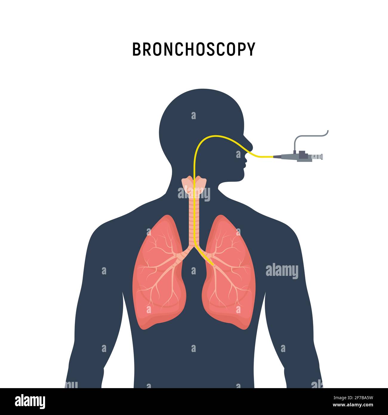 Bronchoscopie système respiratoire emphysème endoscopie examen ...