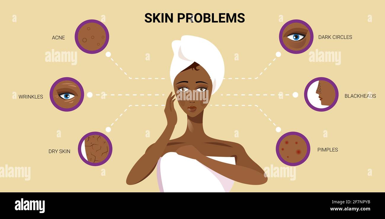 boutons de peau de visage acné différents types sur la femme américaine ...