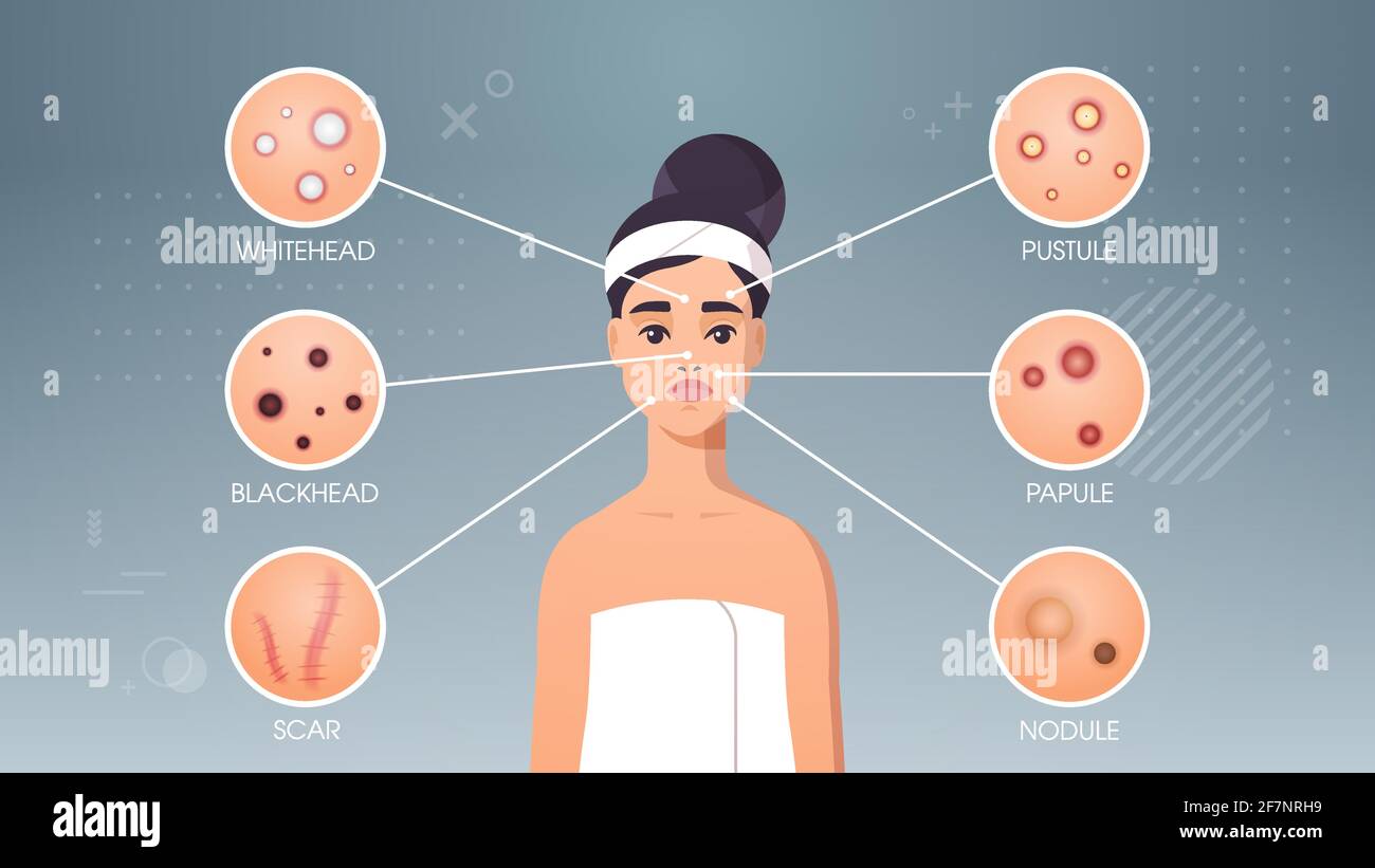 Boutons De Peau Faciale Acné Différents Types Sur Le Visage De La Femme