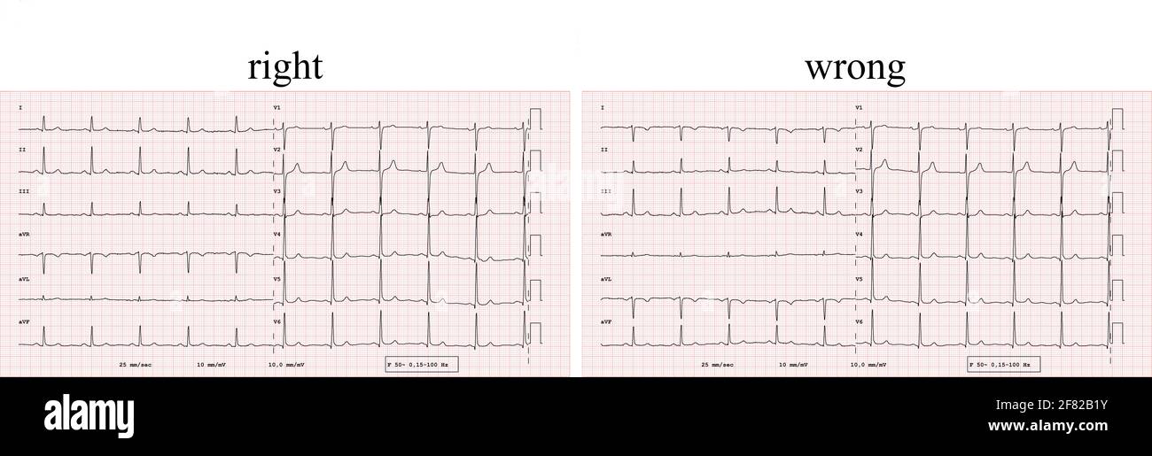 ECG exemple de rythme sinusal normal à 12 dérivations, comparaison du ...