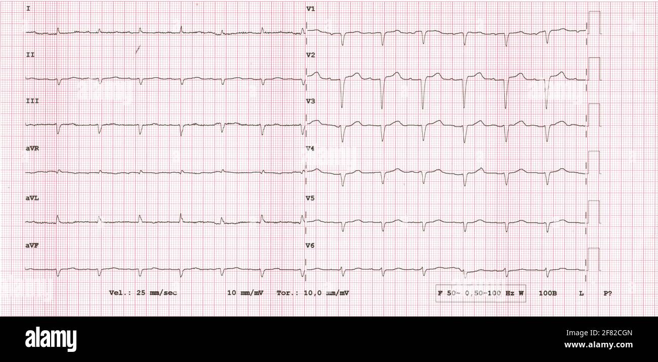 Ecg ekg pathology Banque de photographies et d’images à haute ...