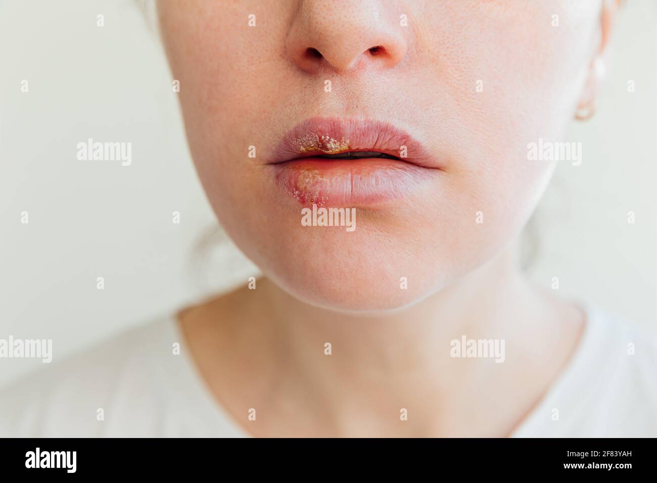 Infection de la peau cloques herpes Banque de photographies et d’images ...