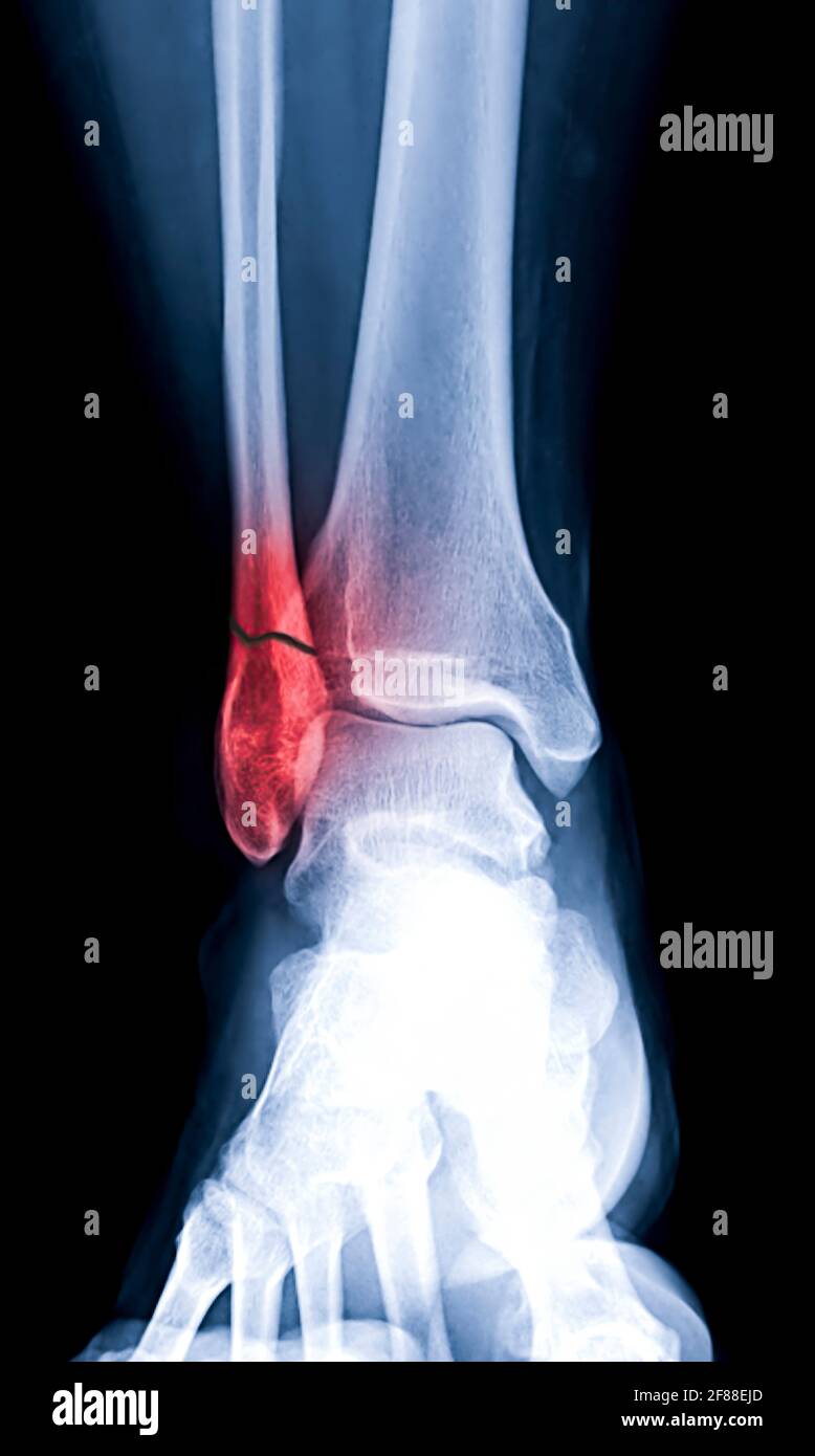 Os de la cheville Banque de photographies et d’images à haute ...