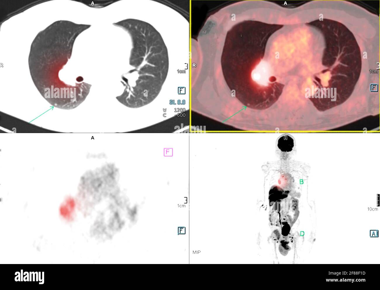 PET Scan image de thorax ou de poitrine comparaison axiale , coronal ...