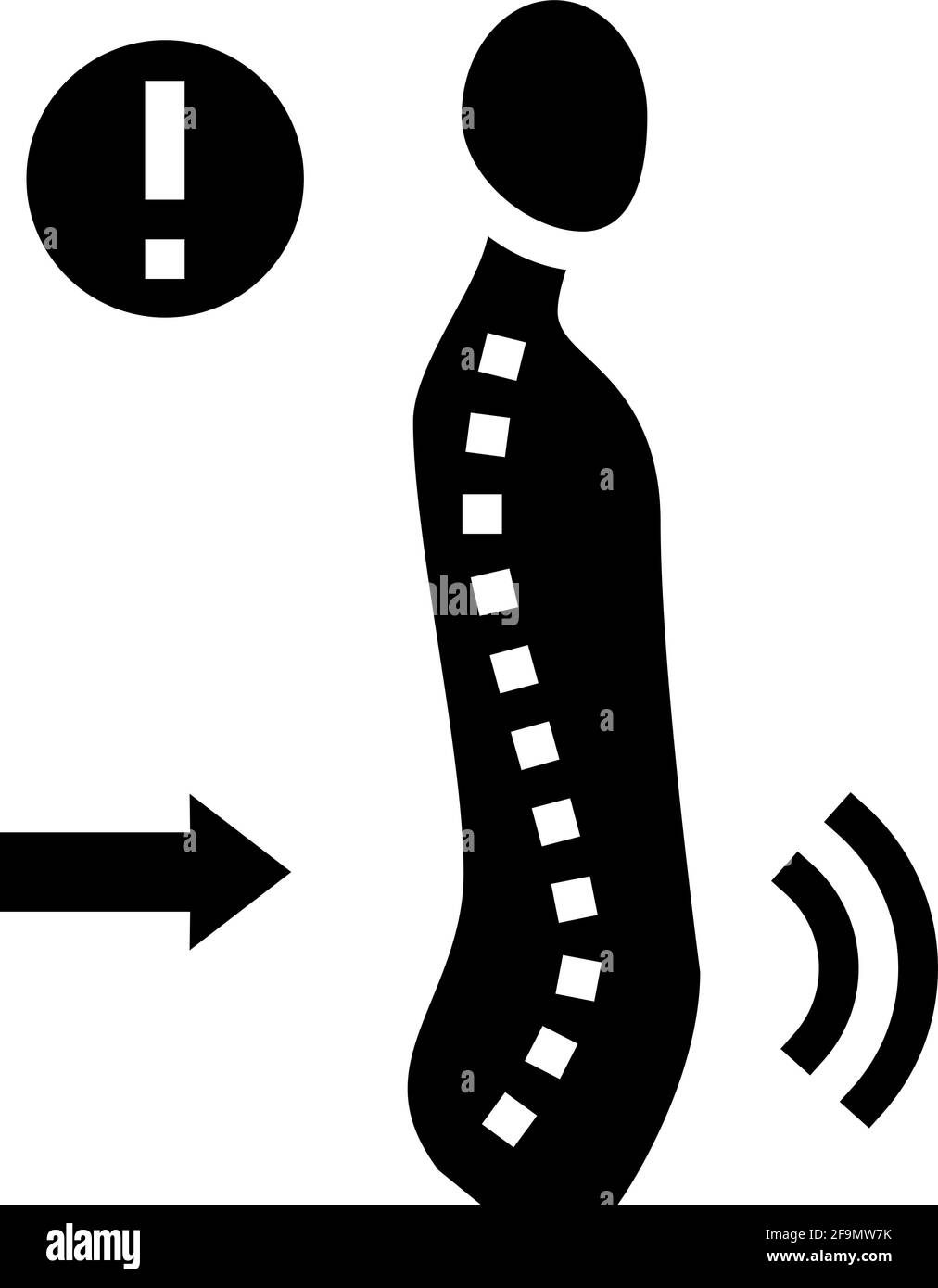 Lordose scoliose cyphose Banque d'images vectorielles - Alamy