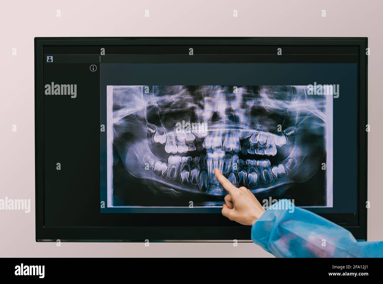 Radiographie panoramique dentaire Banque de photographies et d’images à ...