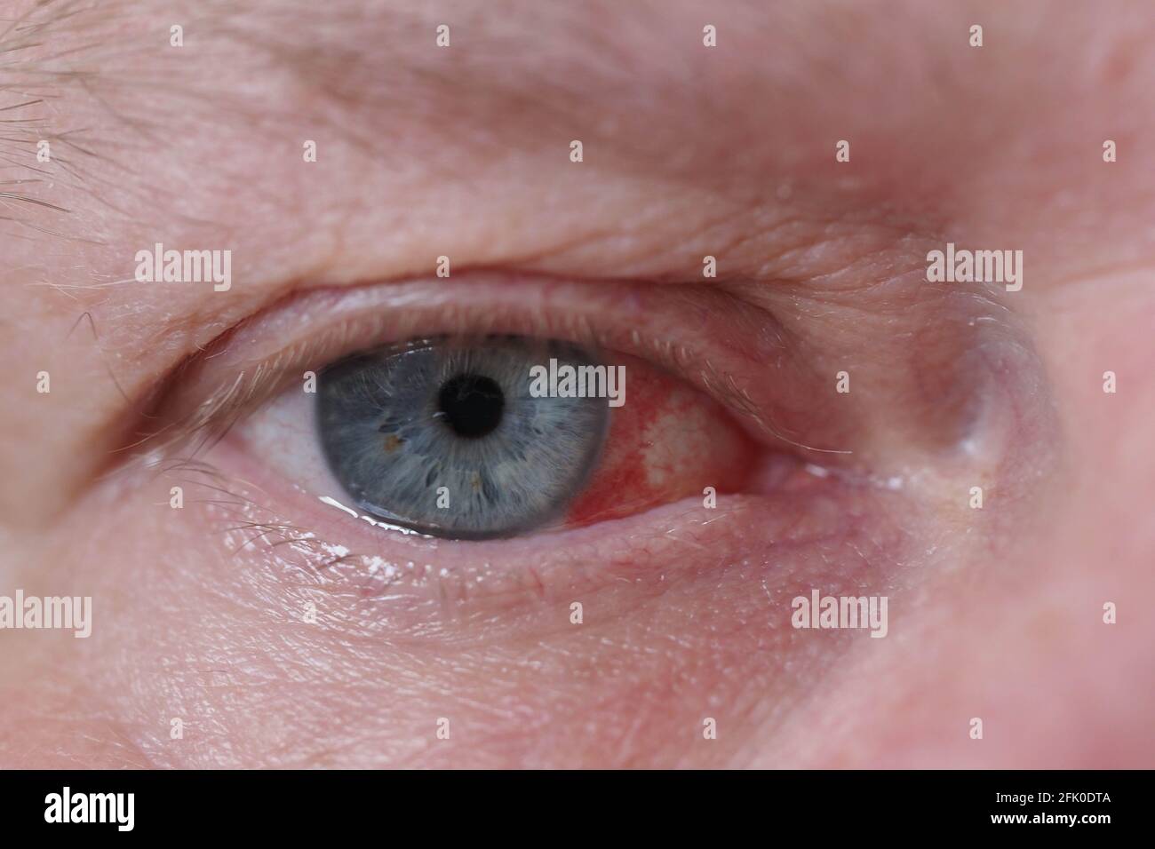 L'œil d'un homme, une macro-étoile. Hémorragie. Œil malade, explosion d ...