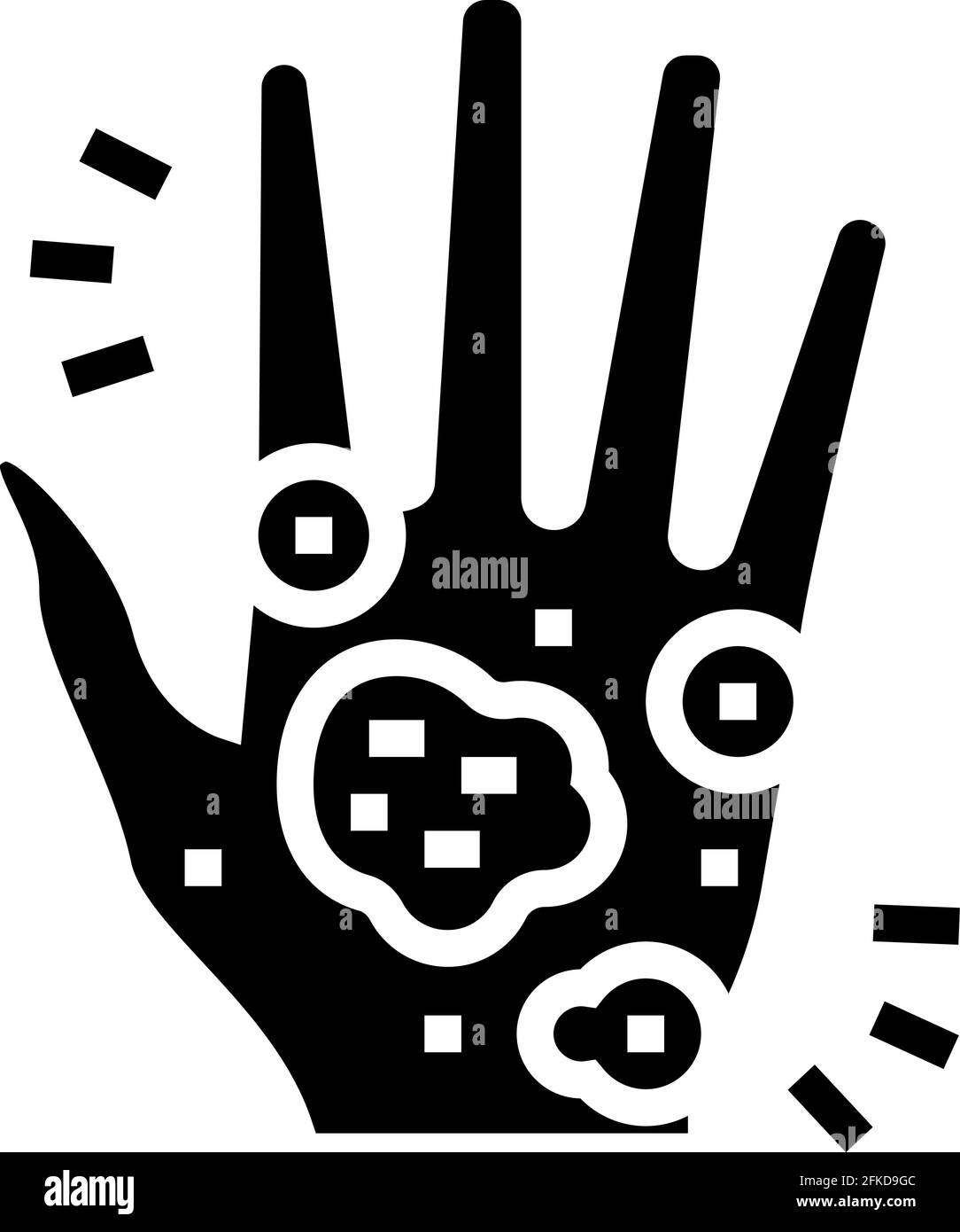 Dyshidrotic eczema Banque de photographies et d’images à haute ...