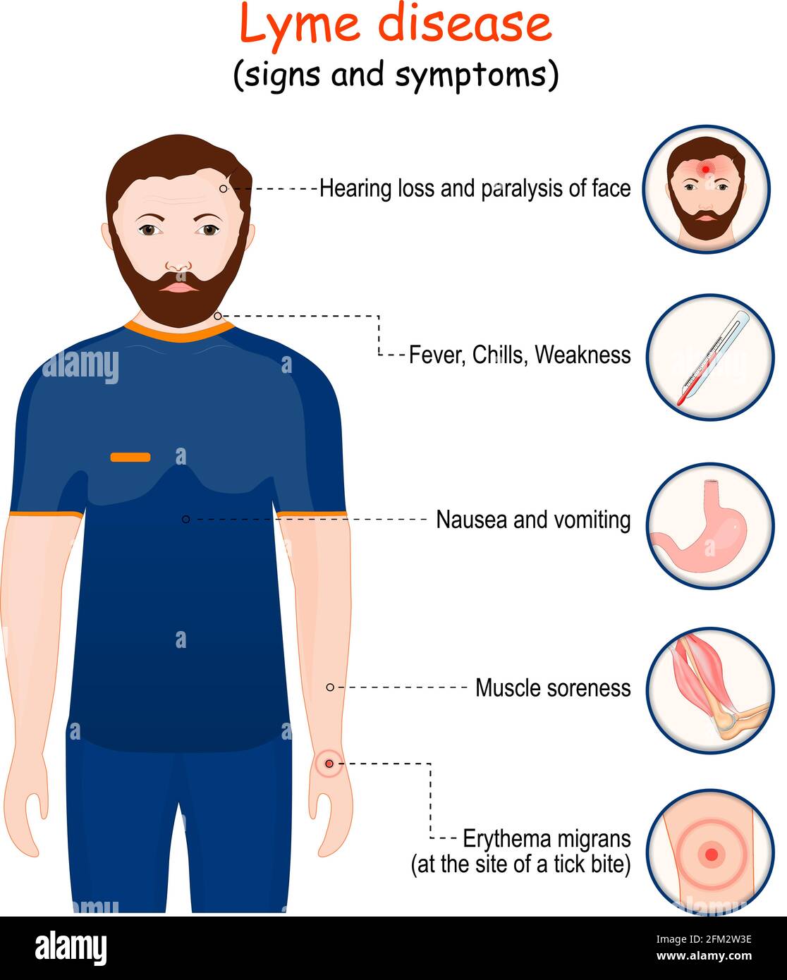 Lyme disease rash Banque d'images vectorielles - Alamy