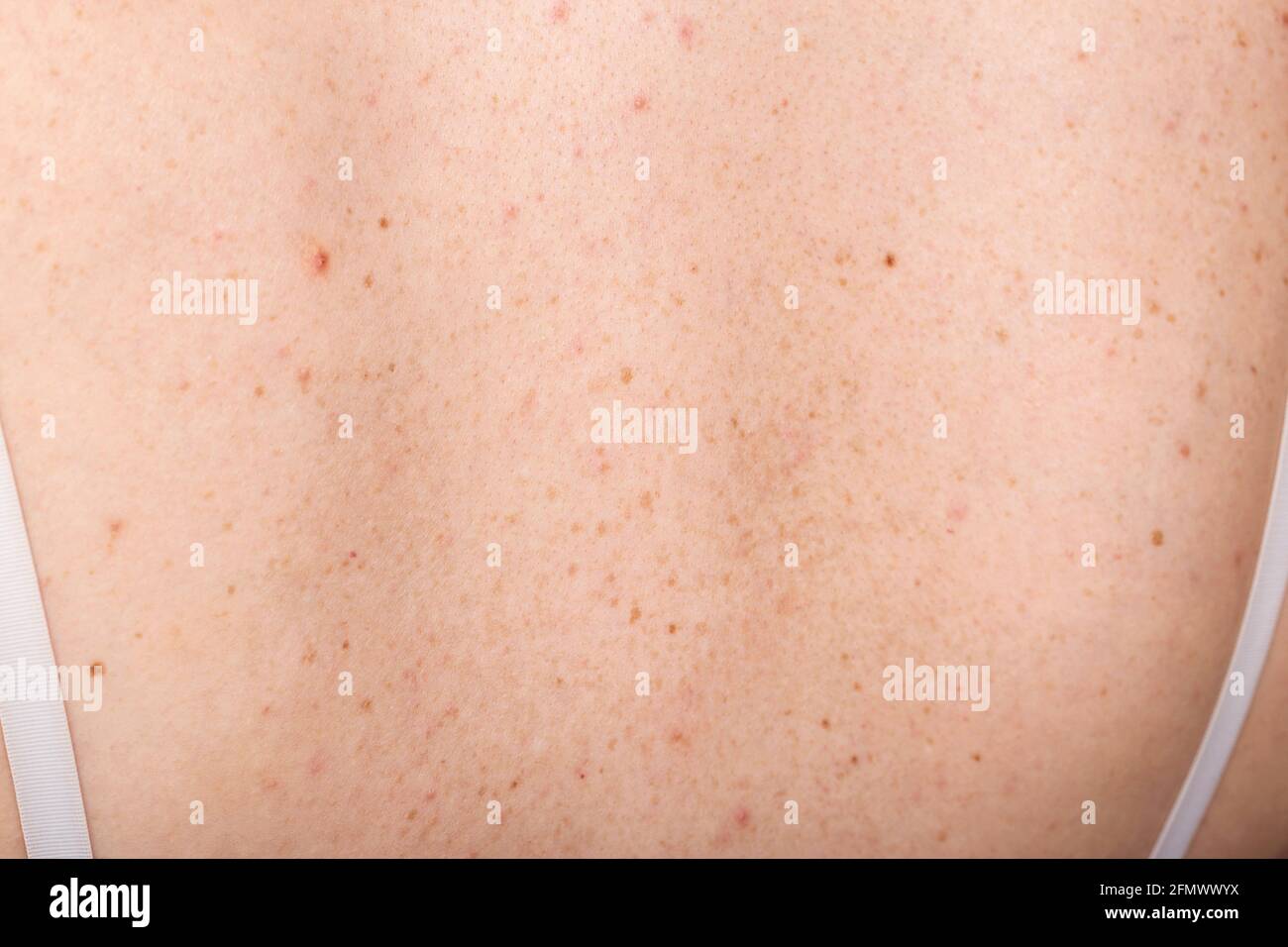 Taches sombres sur le dos Banque de photographies et d’images à haute ...