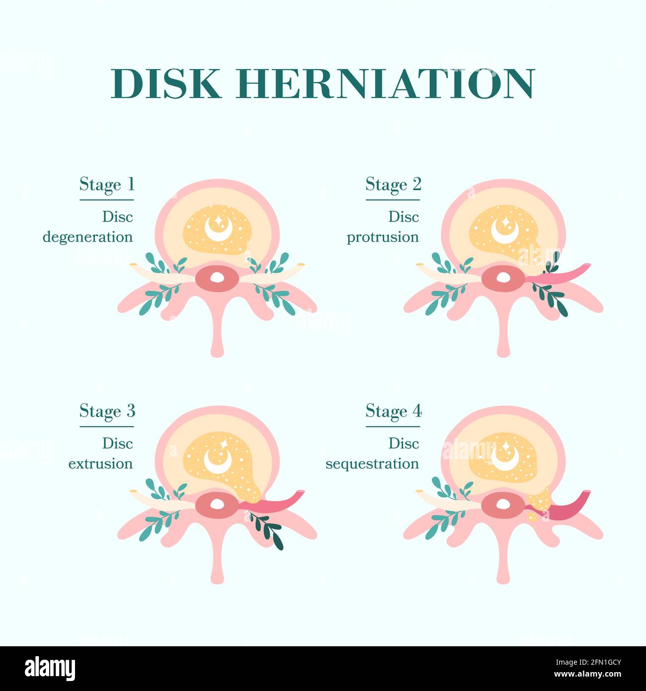 Disque spinal hernié - dégénératif, protrusion, séquestration - vecteur ...