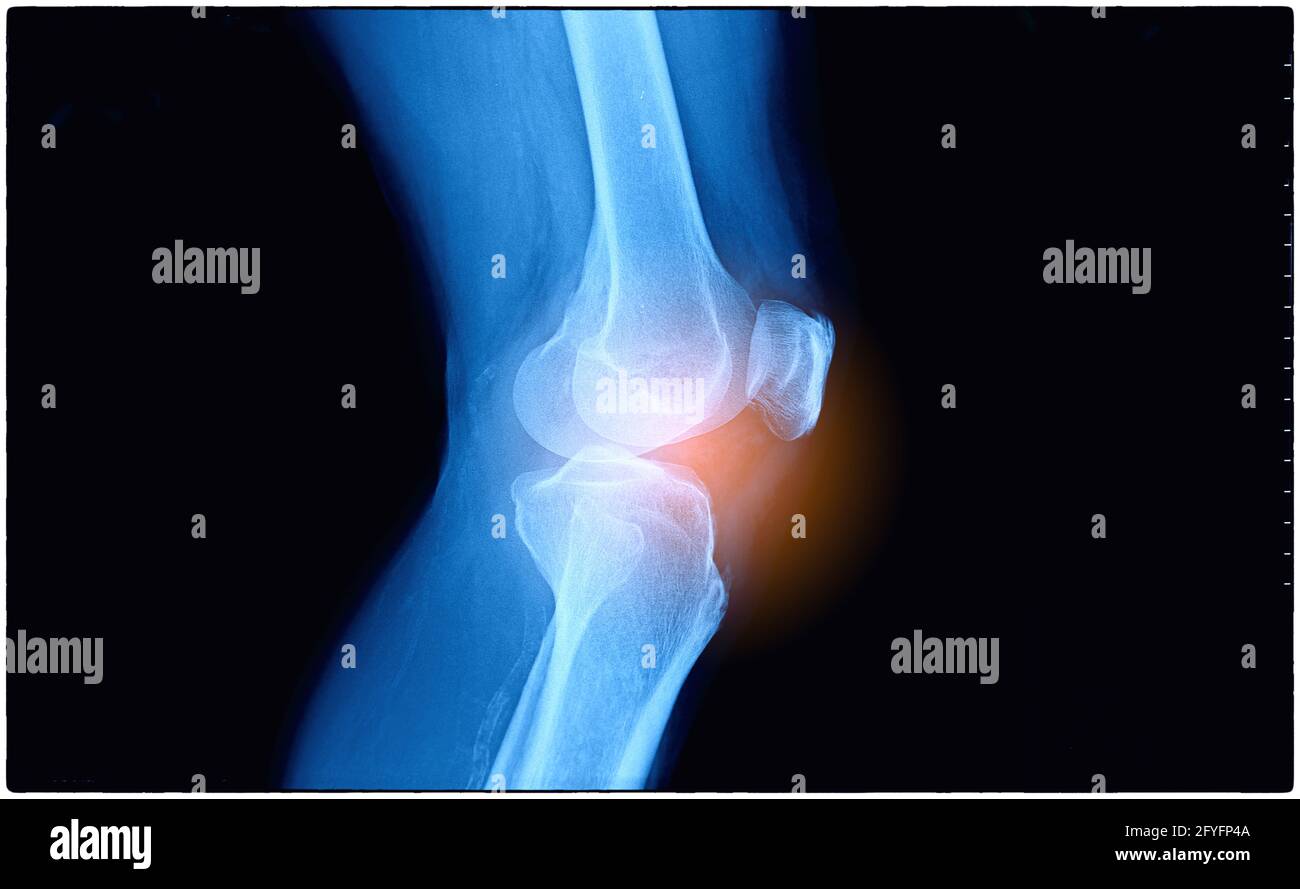 Fracture de la jambe Banque de photographies et d’images à haute ...