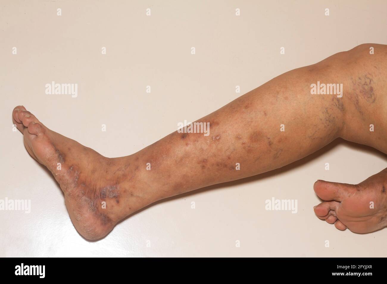 Gros plan des jambes d'une femme souffrant de psoriasis chronique sur ...