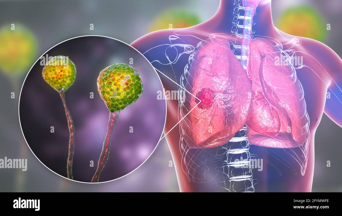 Mucormycose pulmonaire Banque de photographies et d’images à haute résolution - Alamy