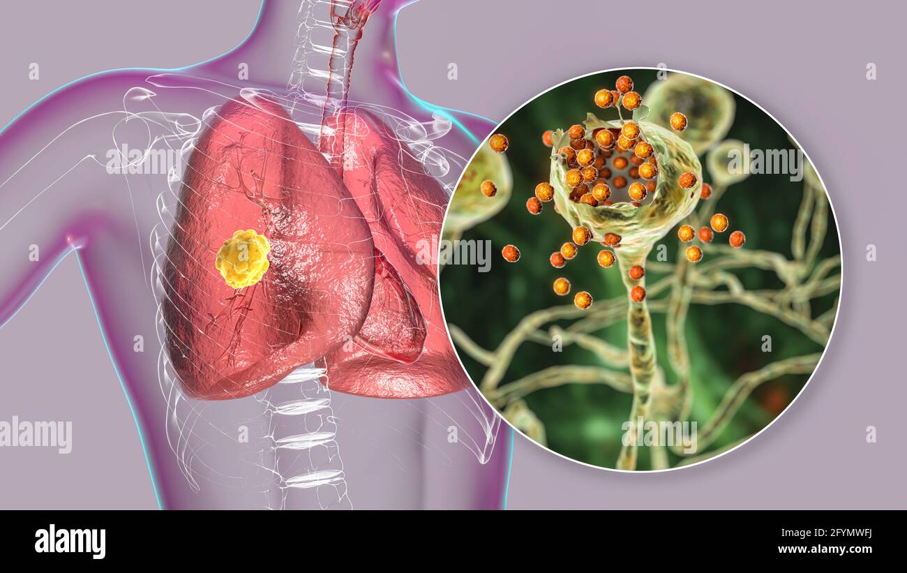 Mucormycose pulmonaire Banque de photographies et d’images à haute résolution - Alamy
