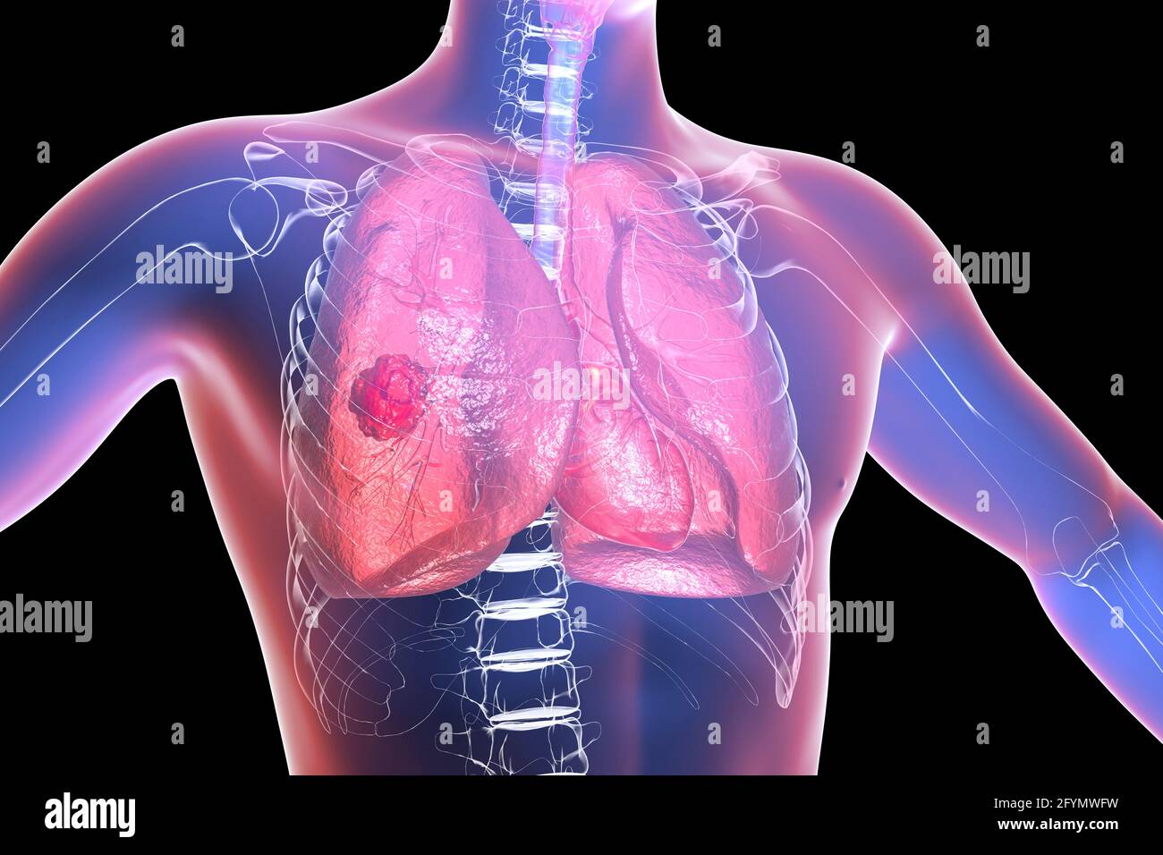 Mucormycose pulmonaire, illustration Photo Stock - Alamy