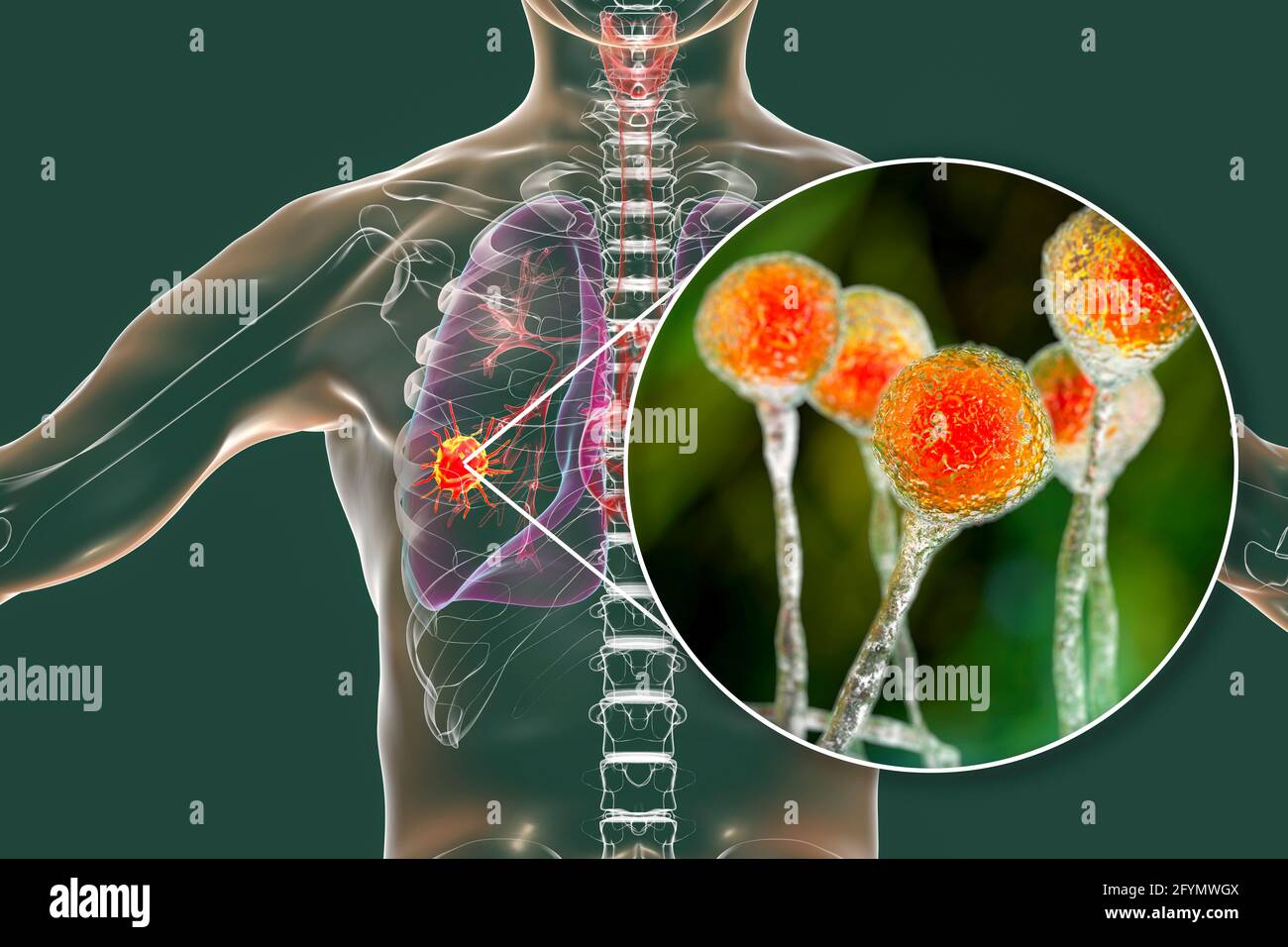 Mucormycose pulmonaire Banque de photographies et d’images à haute résolution - Alamy