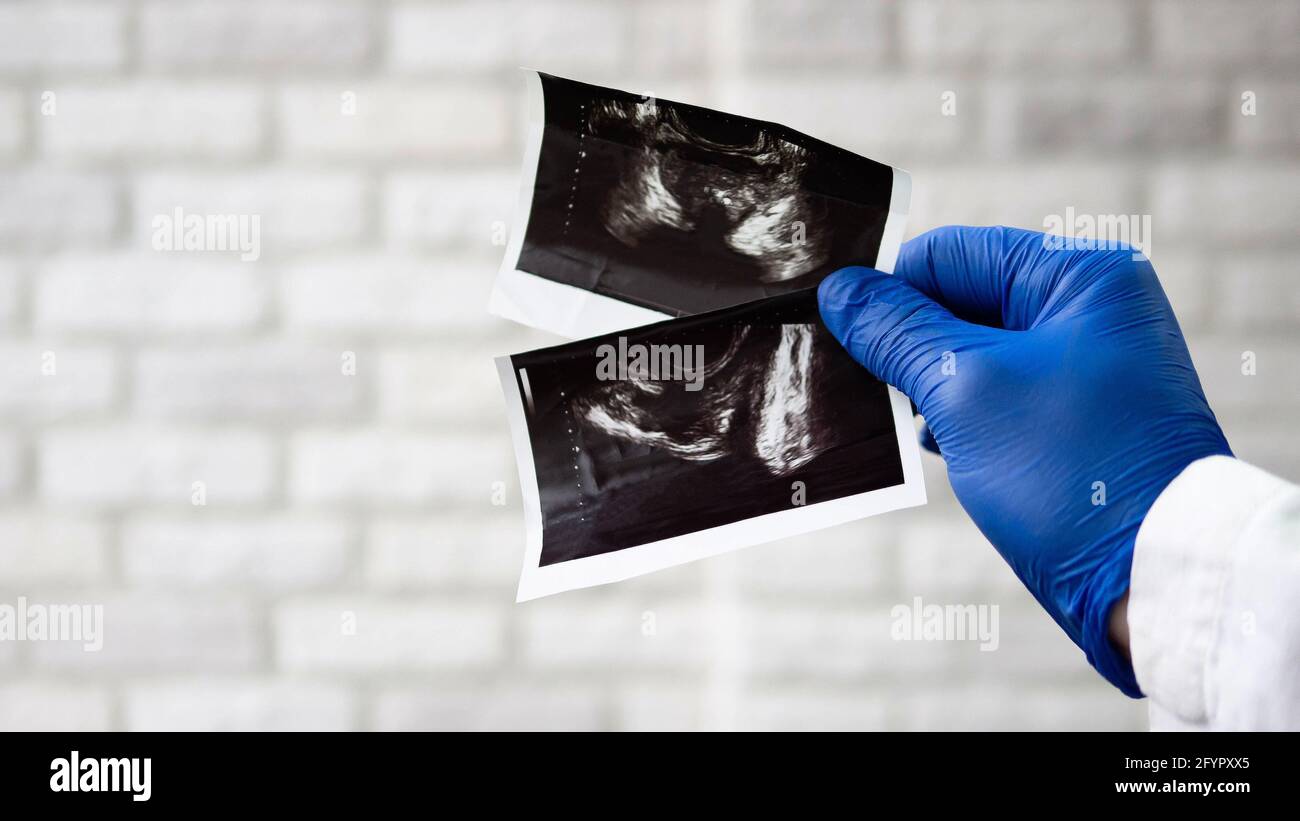 Traitement hypertrophie de la prostate Banque de photographies et d ...