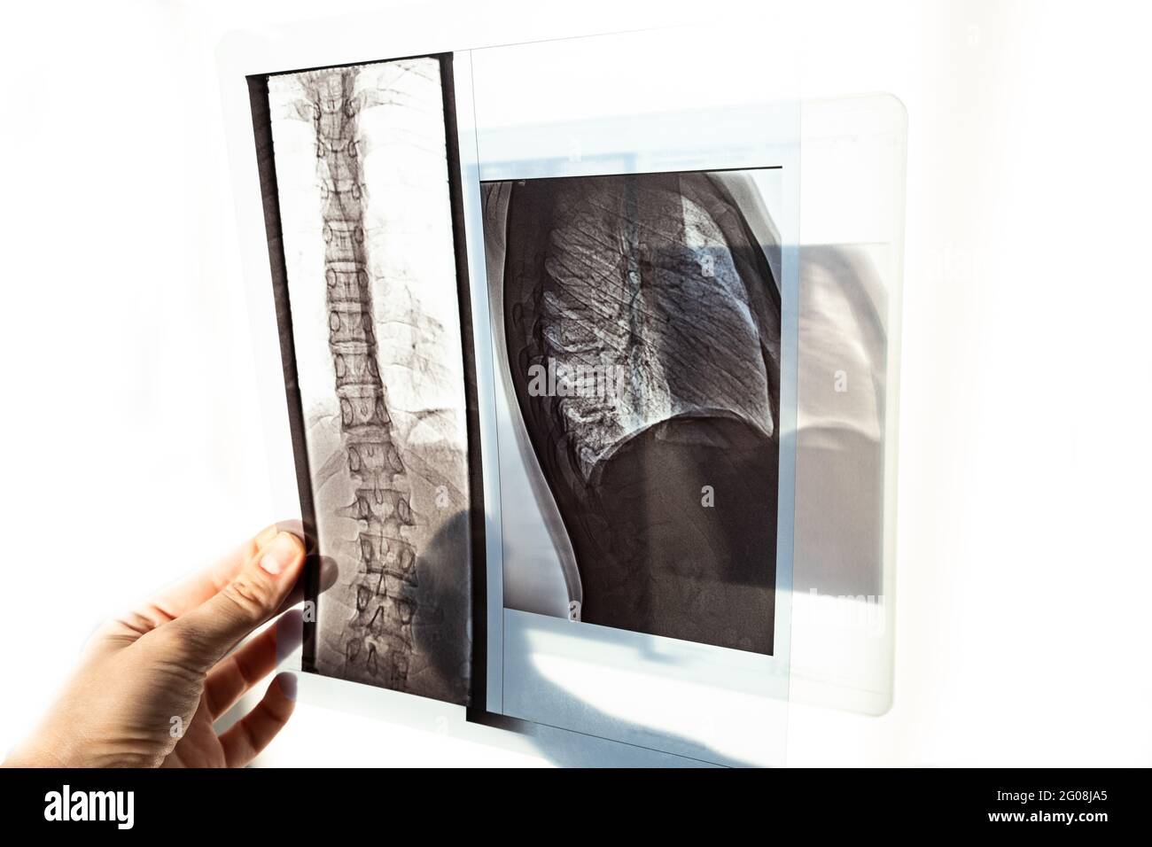 Courbure de la colonne vertébrale Banque de photographies et d’images à ...