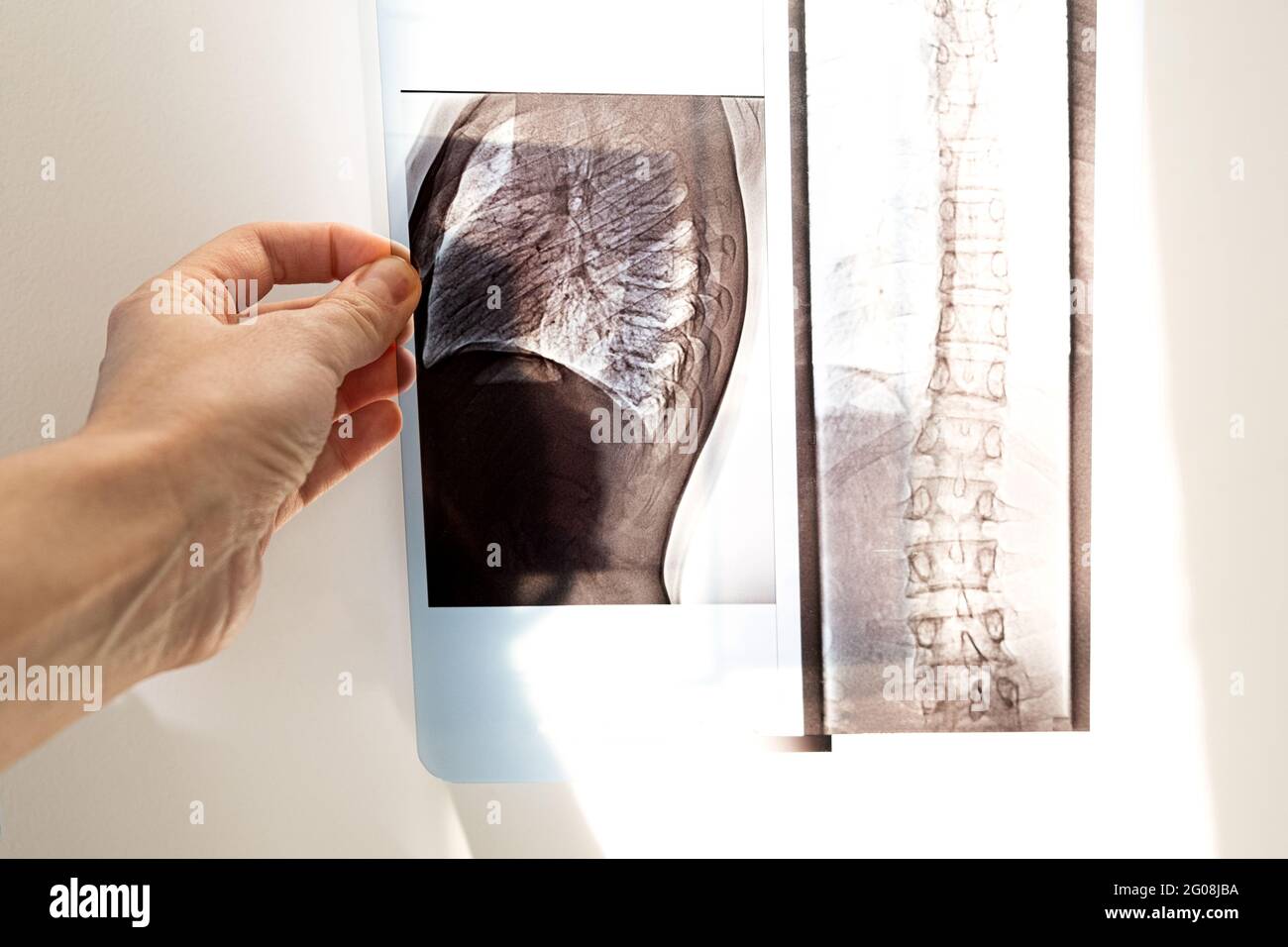 Courbure de la colonne vertébrale Banque de photographies et d’images à ...