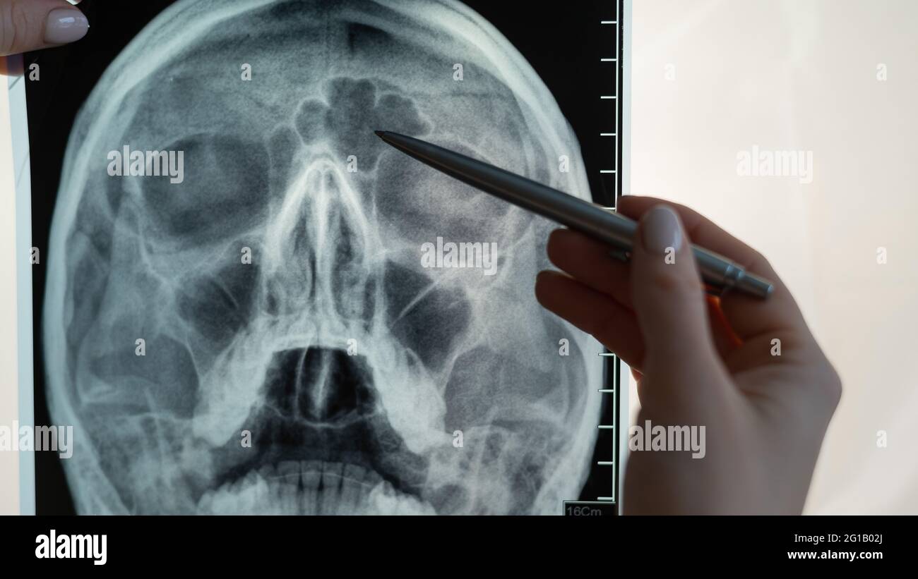Rayons X de la tête humaine. Le médecin signale les signes de sinusite ...