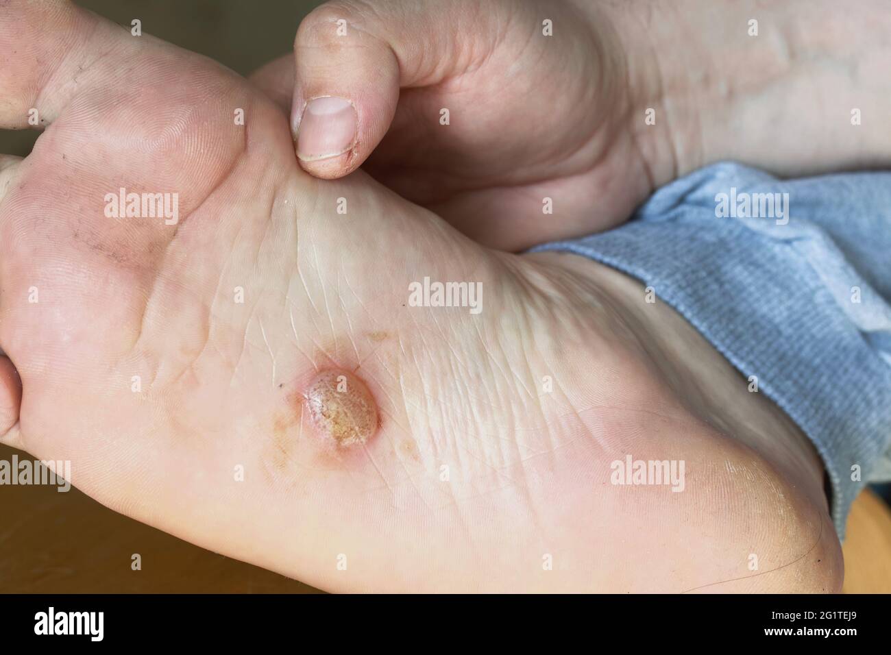 Eczéma dyshidrotique sur le pied. L'homme montre une dermatite cloque ...