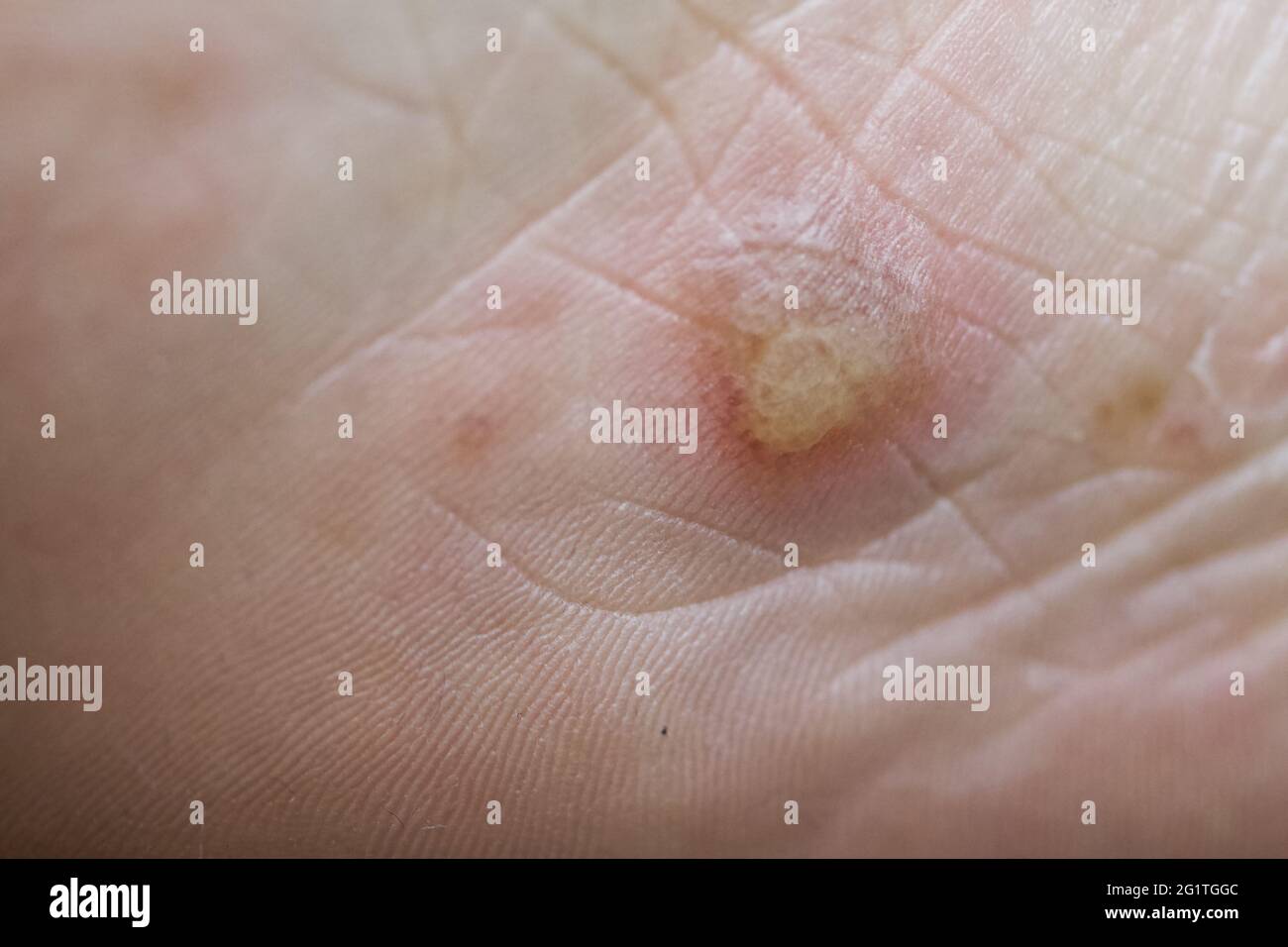 Eczéma dyshidrotique sur le pied. Dermatite de plaquette. Gros plan ...