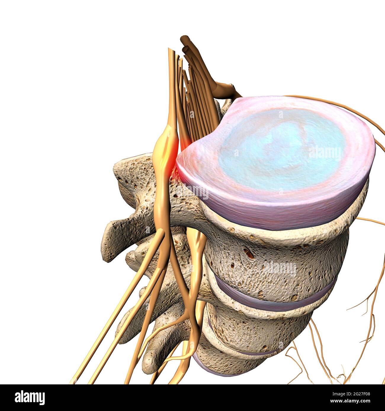Un disque hernié appuyant sur un nerf spinal, sur fond blanc Photo ...