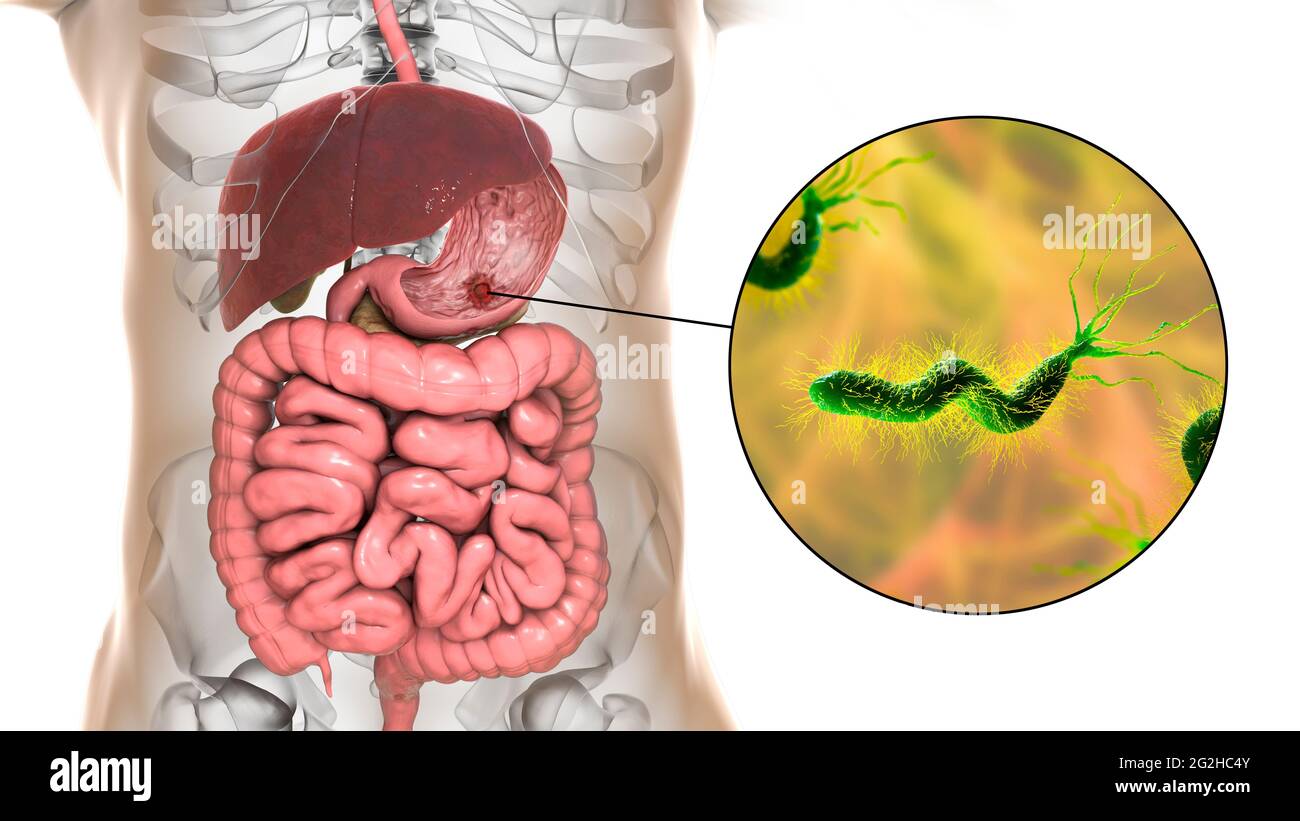 Ulcère gastrique et bactéries Helicobacter pylori, illustration Photo ...