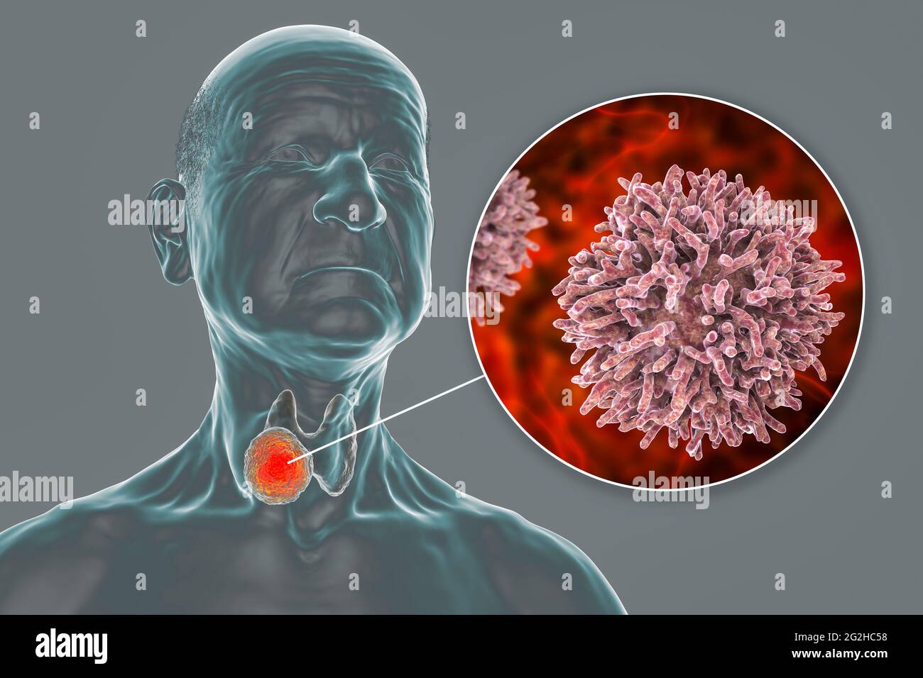 Cancer de la glande thyroïde, illustration Photo Stock - Alamy
