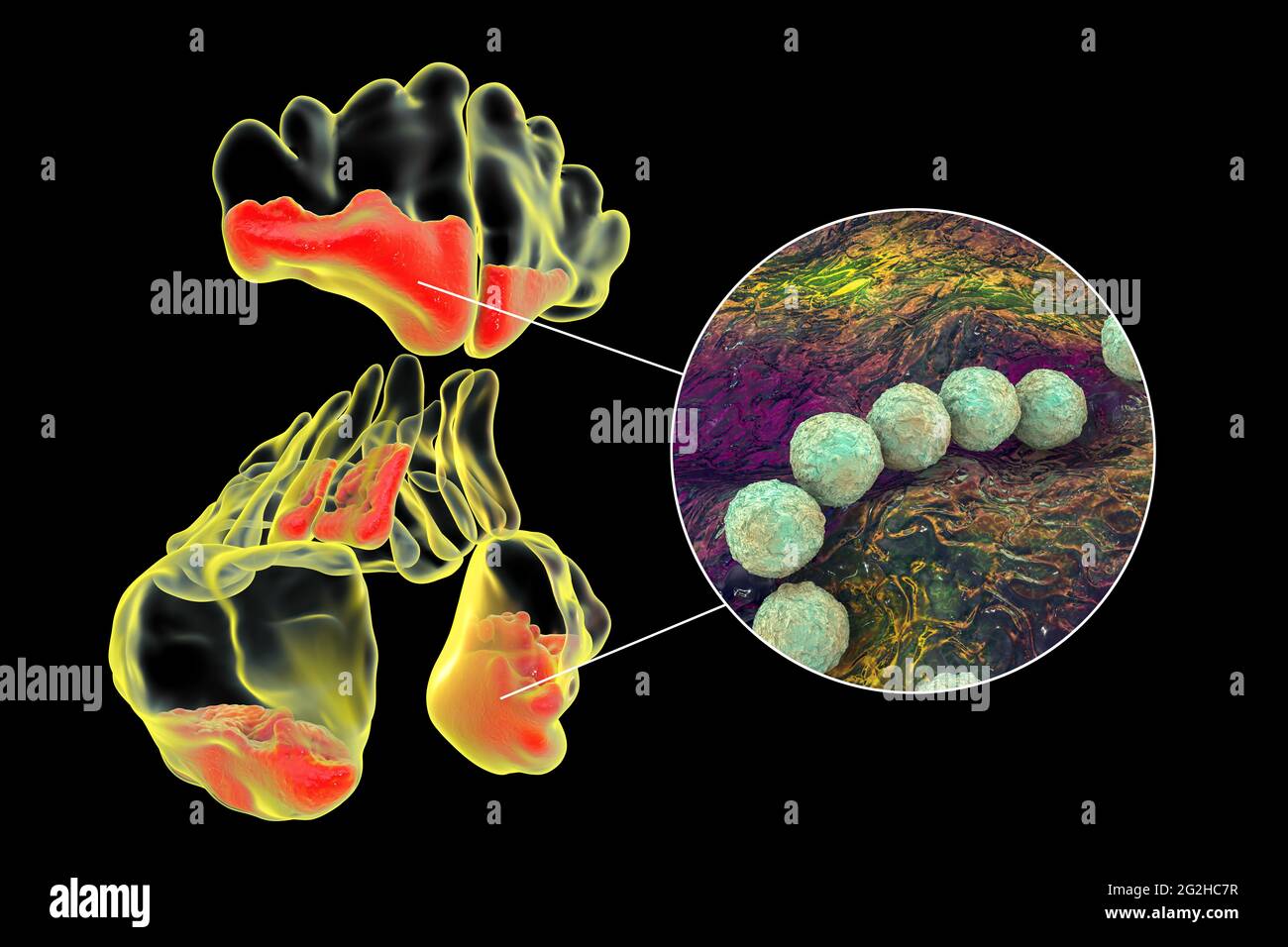Sinusite bactérienne Banque de photographies et d’images à haute ...