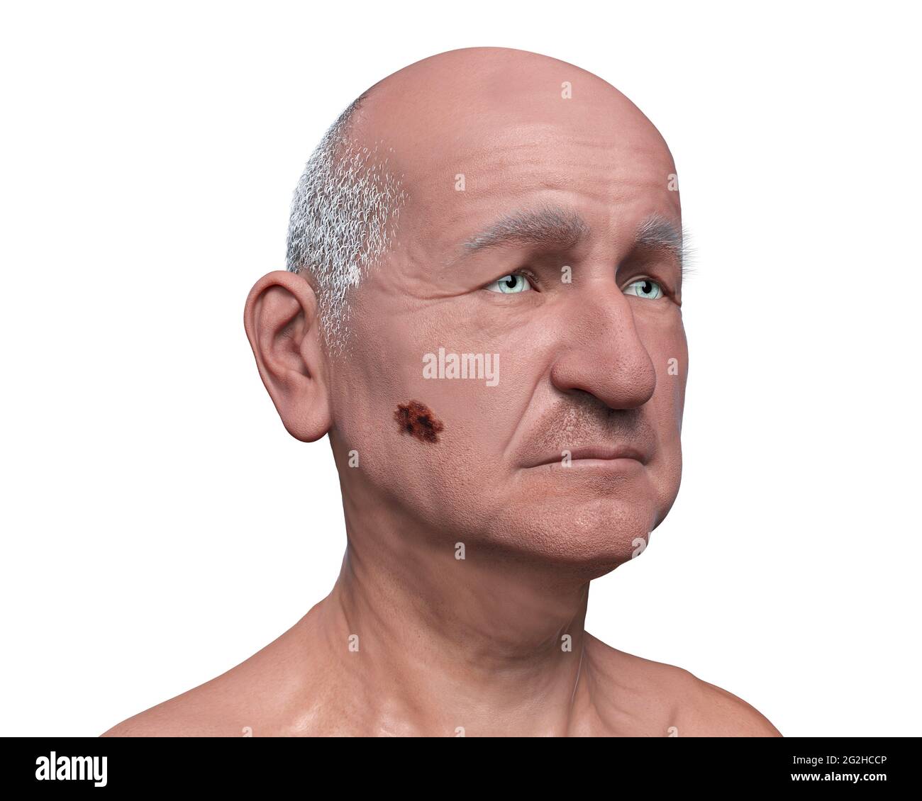 Mélanome malin Banque de photographies et d’images à haute résolution - Alamy