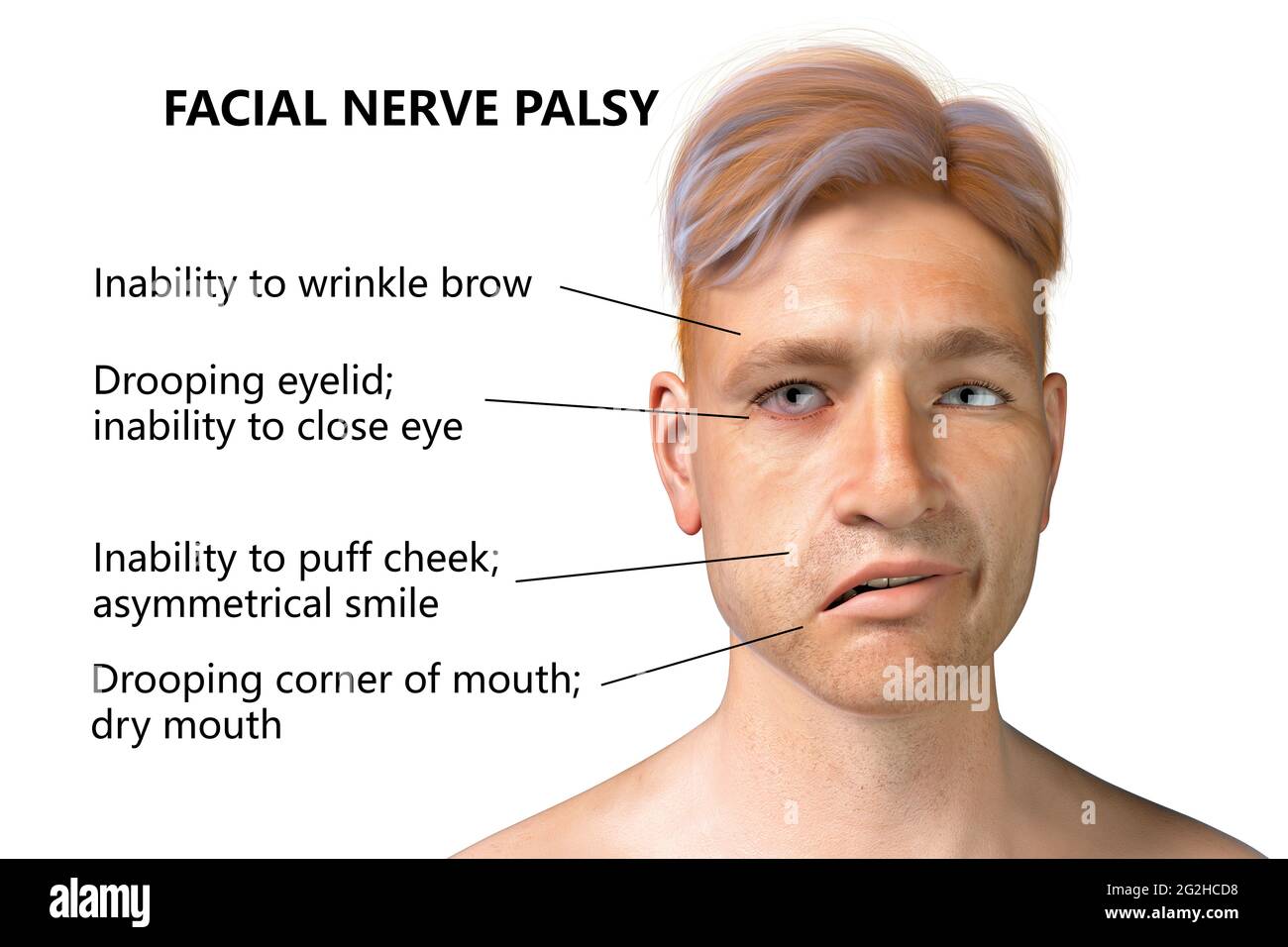 Bells palsy Banque de photographies et d’images à haute résolution - Alamy