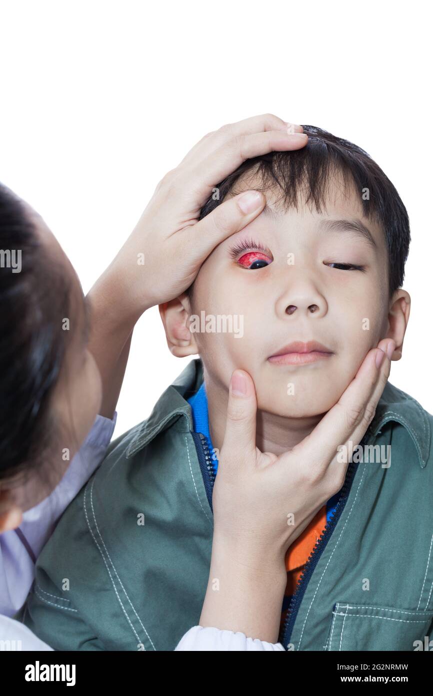 Œil injecté de sang yeux Banque de photographies et d’images à haute ...