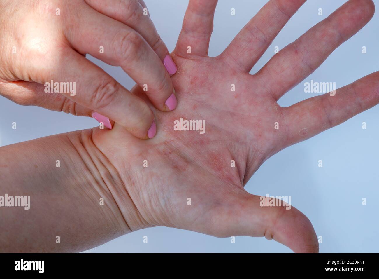 Dermatite atopique, mains rouges, problème dermatologique, mains ...