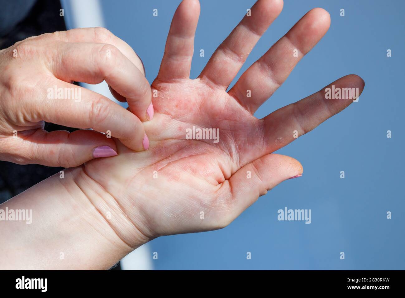Femme rayant la main qui démange, concept, dermatite atopique, mains ...