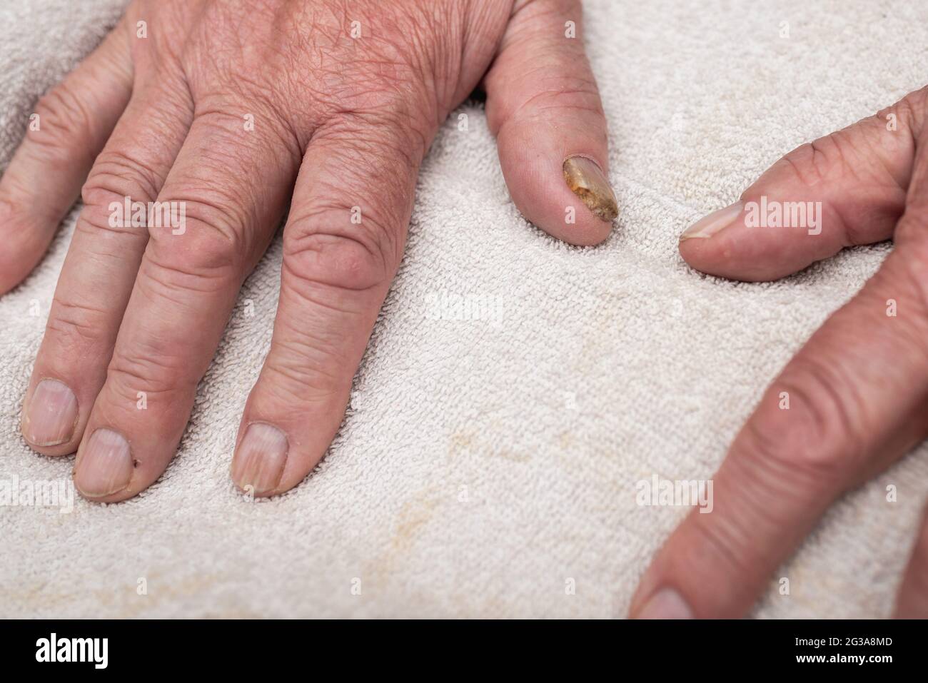 Mycose des ongles Banque de photographies et d’images à haute ...