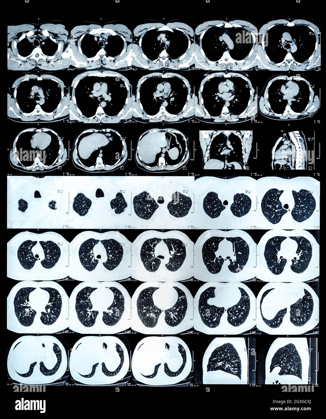 Mri of normal thoracic spine Banque de photographies et d’images à ...