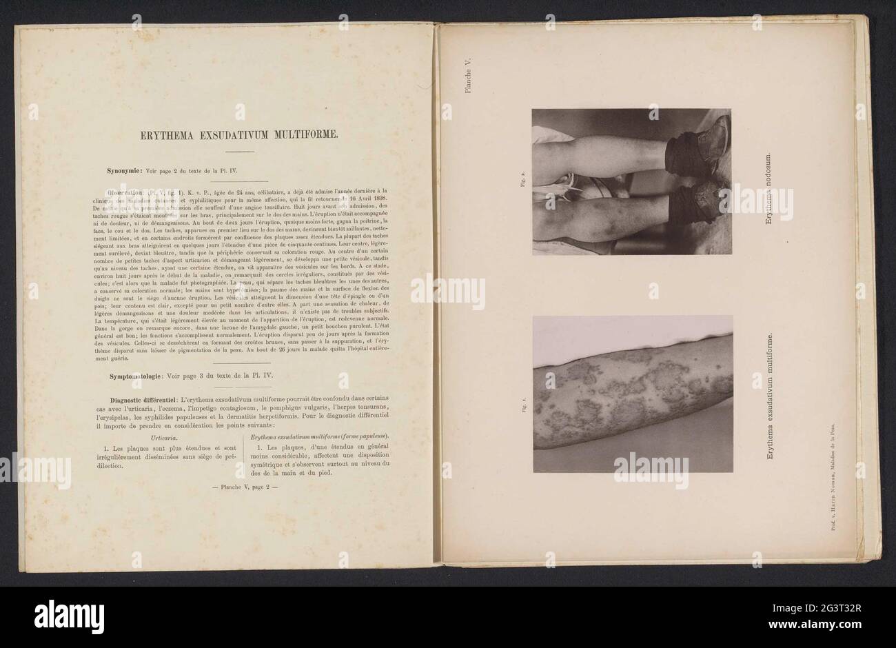 Erythema multiforme Banque de photographies et d’images à haute ...