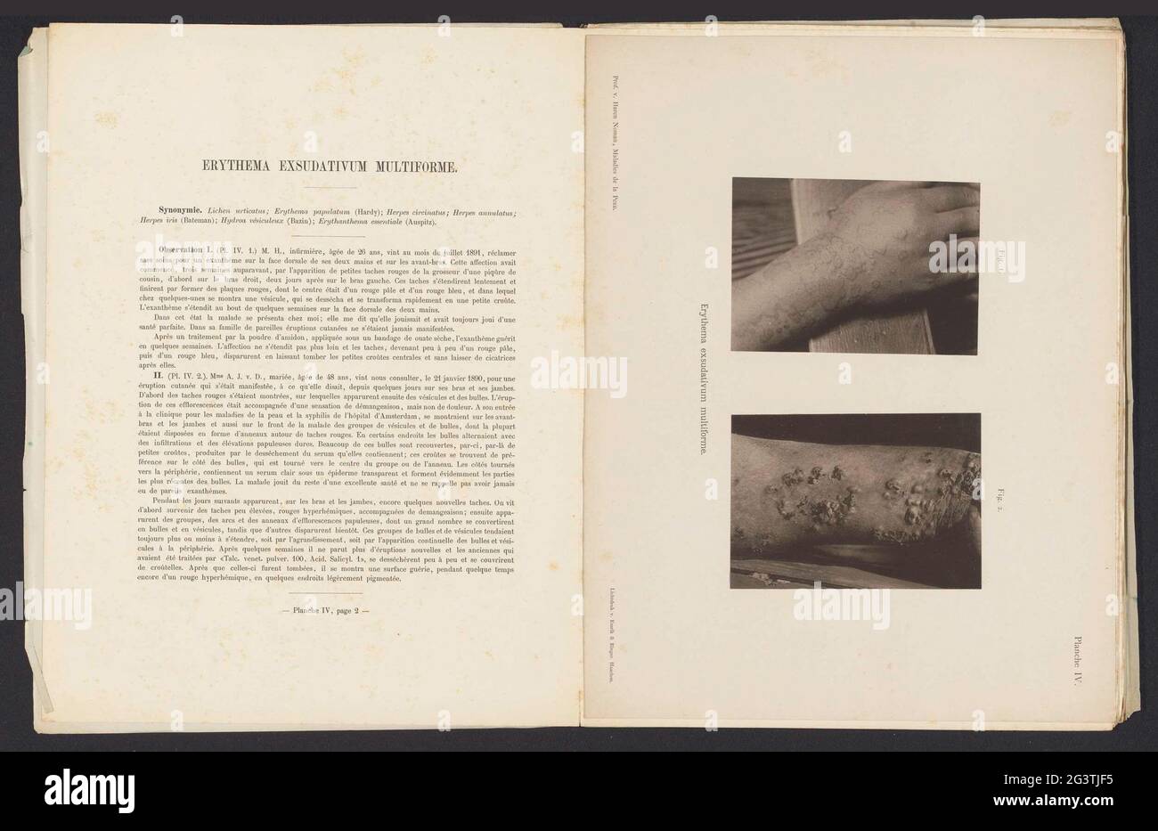 Erythema multiforme Banque de photographies et d’images à haute ...