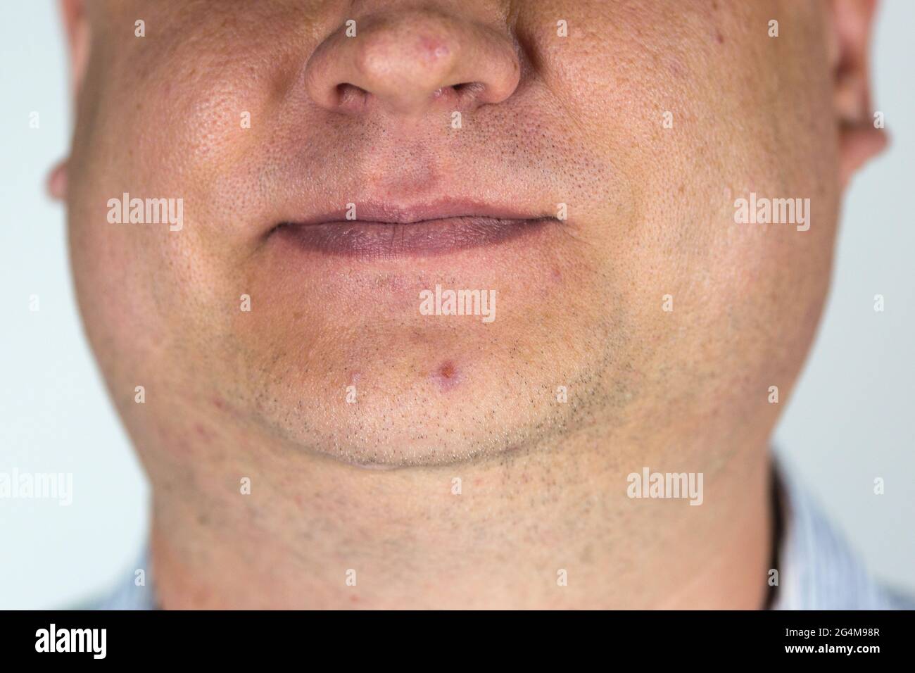 Skin abscess Banque de photographies et d’images à haute résolution ...