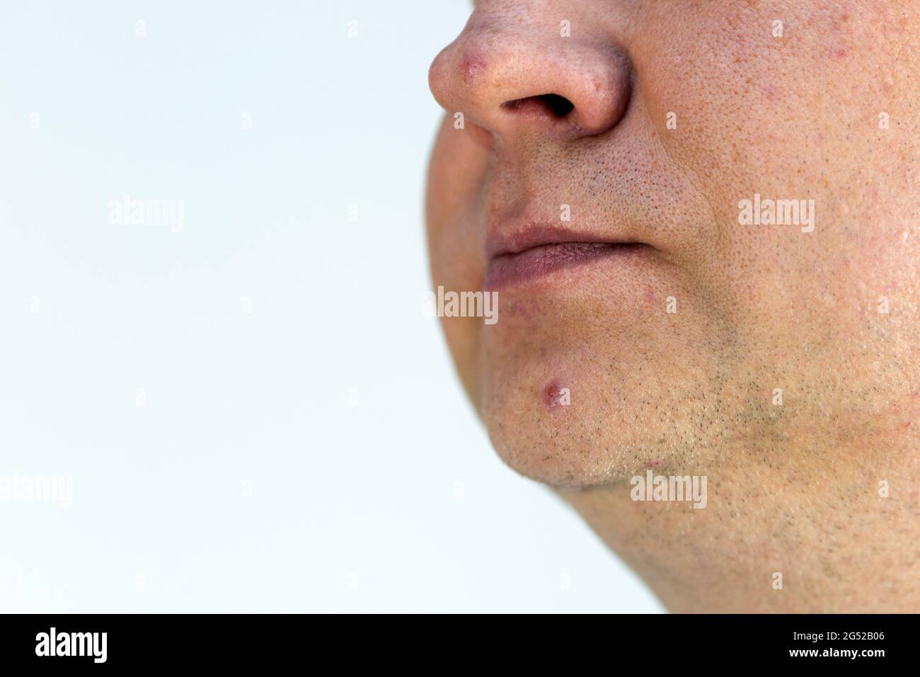 Pimple on nose Banque de photographies et d’images à haute résolution - Alamy