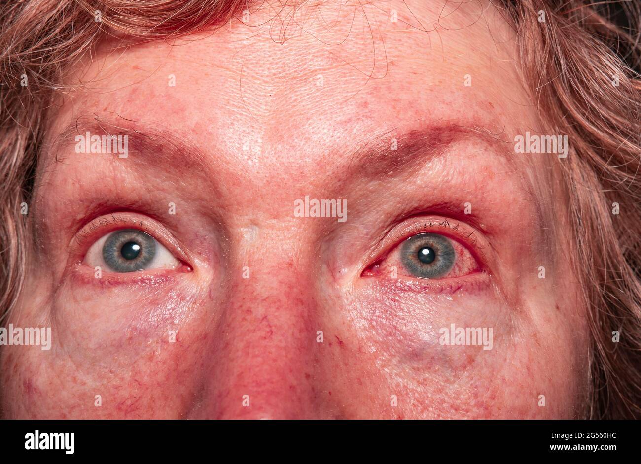 Subconjunctival hemorrhage Banque de photographies et d’images à haute ...